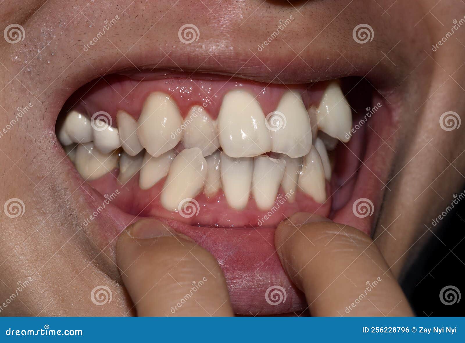 Stacked or Overlapping White Teeth. Also Called Crowded Teeth Stock ...
