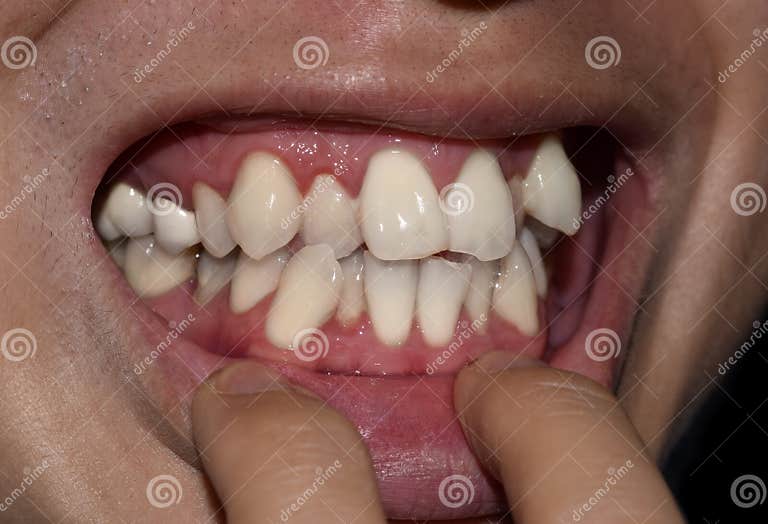 Stacked or Overlapping White Teeth. Also Called Crowded Teeth Stock ...