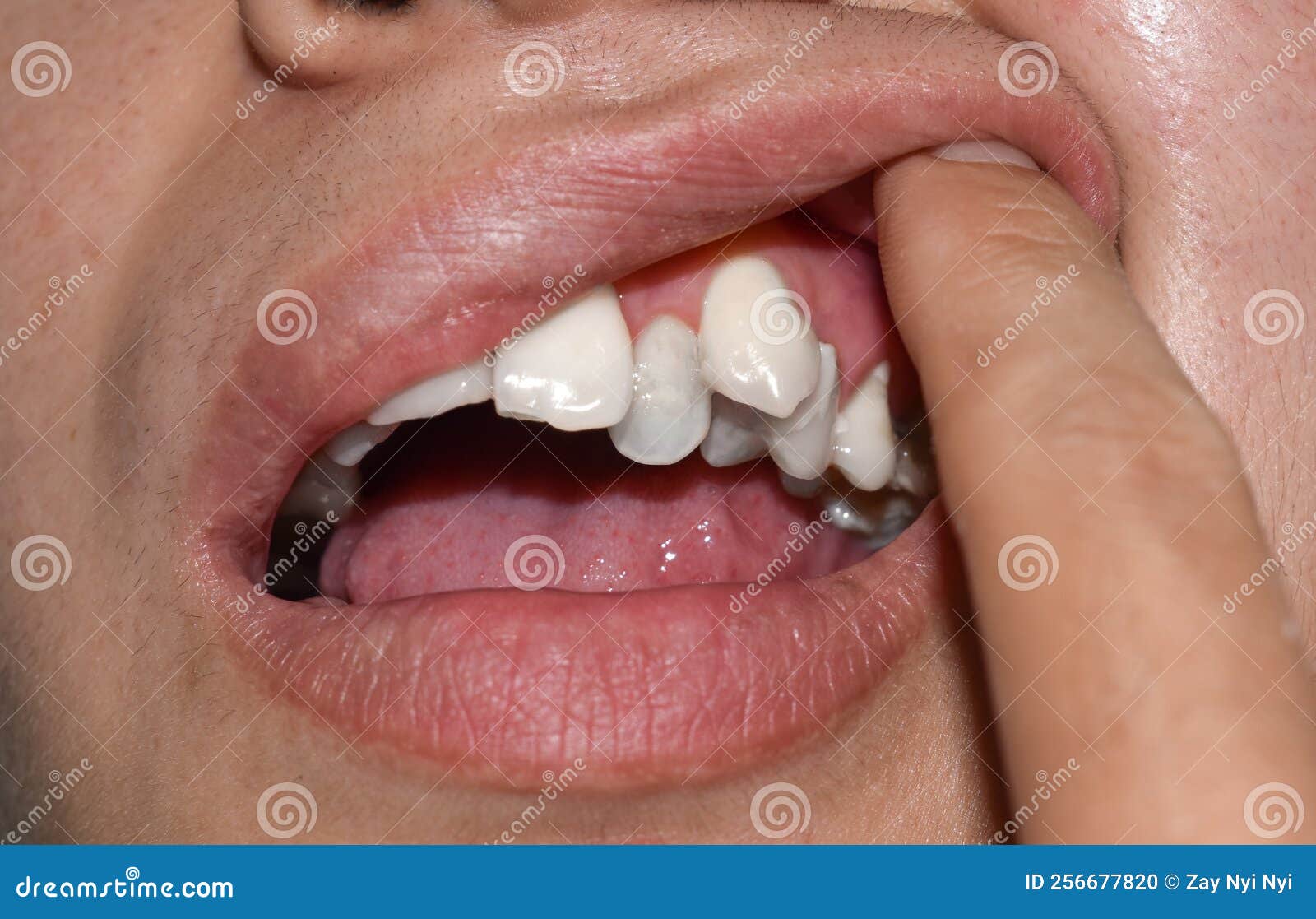 Stacked or Overlapping White Teeth. Also Called Crowded Teeth Stock ...