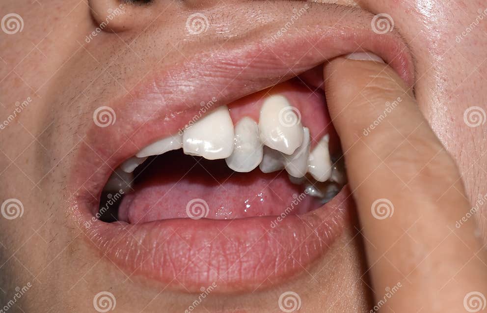 Stacked or Overlapping White Teeth. Also Called Crowded Teeth Stock ...