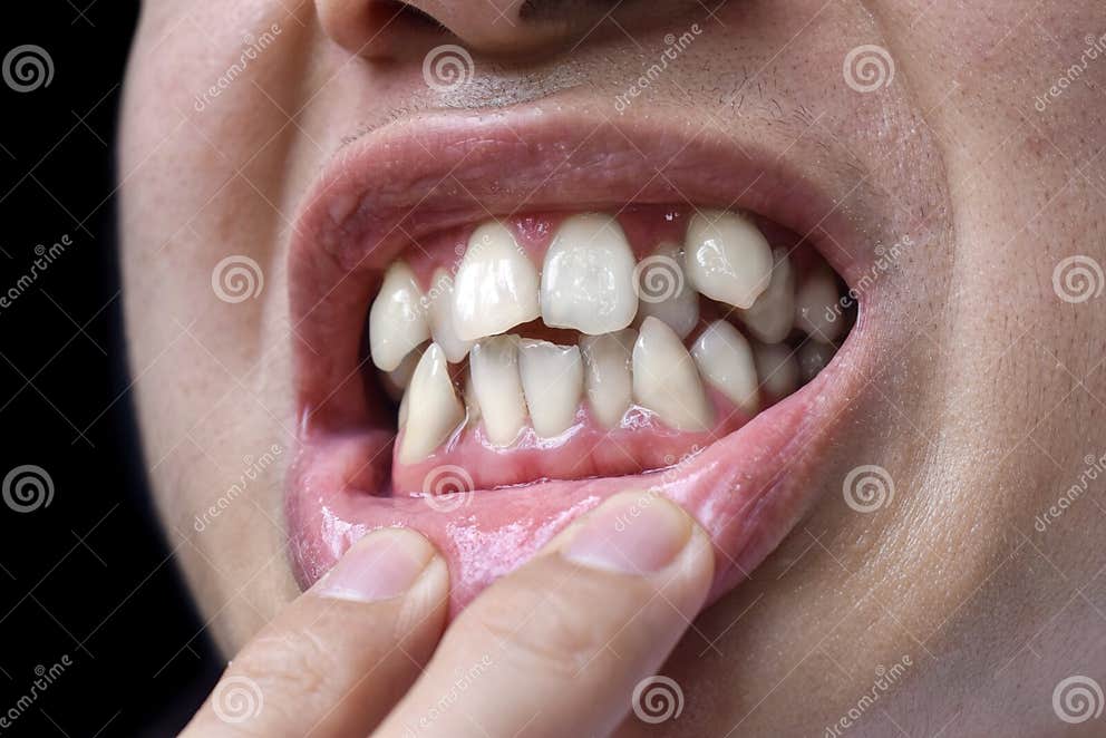 Stacked or Overlapping White Teeth. Also Called Crowded Teeth Stock ...