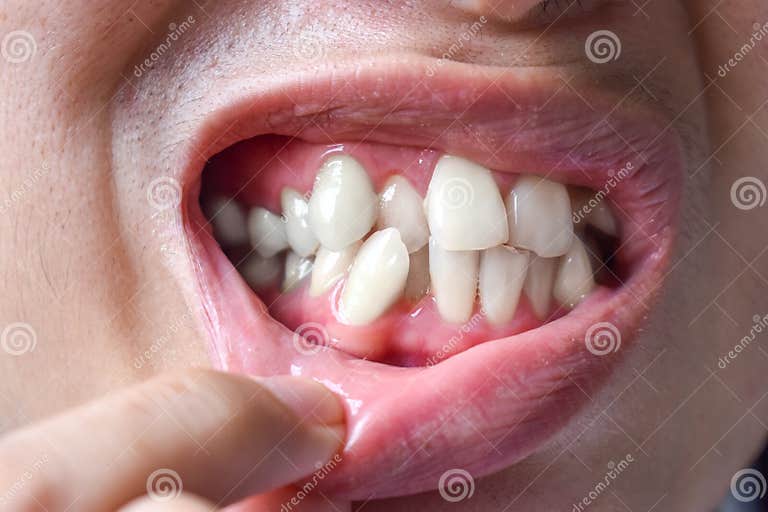 Stacked or Overlapping White Teeth. Also Called Crowded Teeth Stock ...