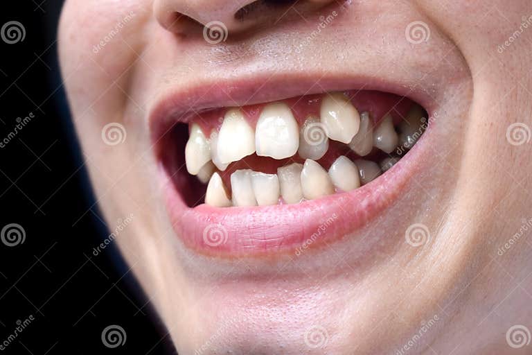 Stacked or Overlapping White Teeth. Also Called Crowded Teeth Stock ...
