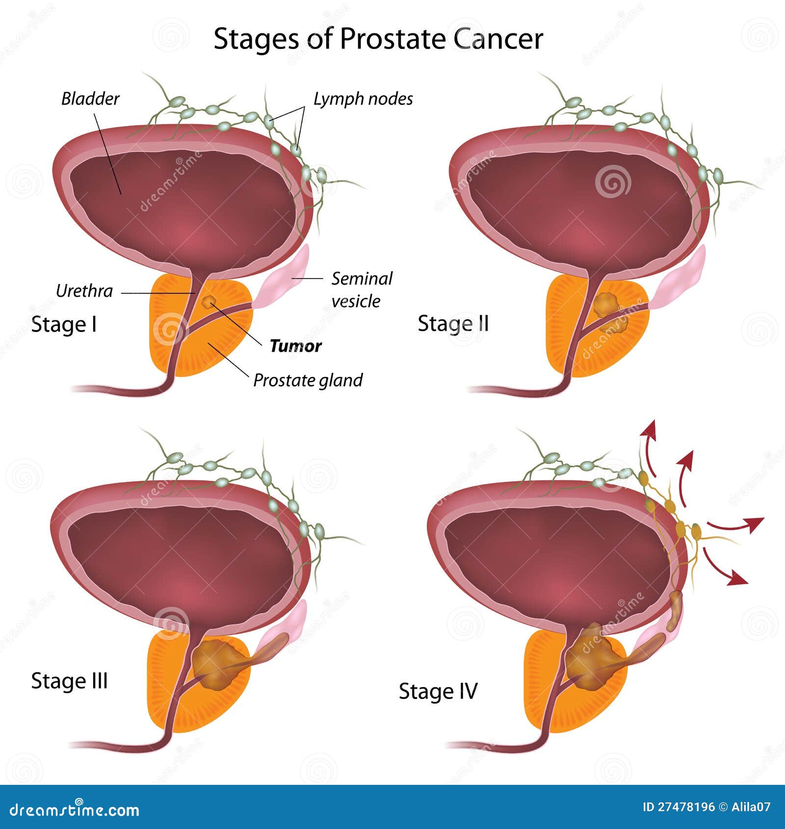 Stadia van prostate kanker vector illustratie. Illustration of lymfe ...