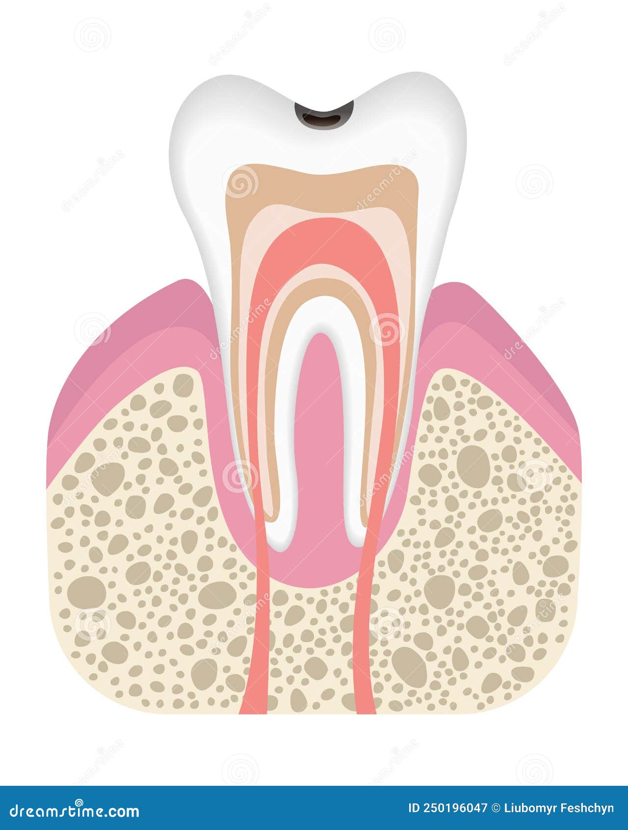 Stage of Caries Development. Tooth Structure in Flat Style. Tooth Decay ...