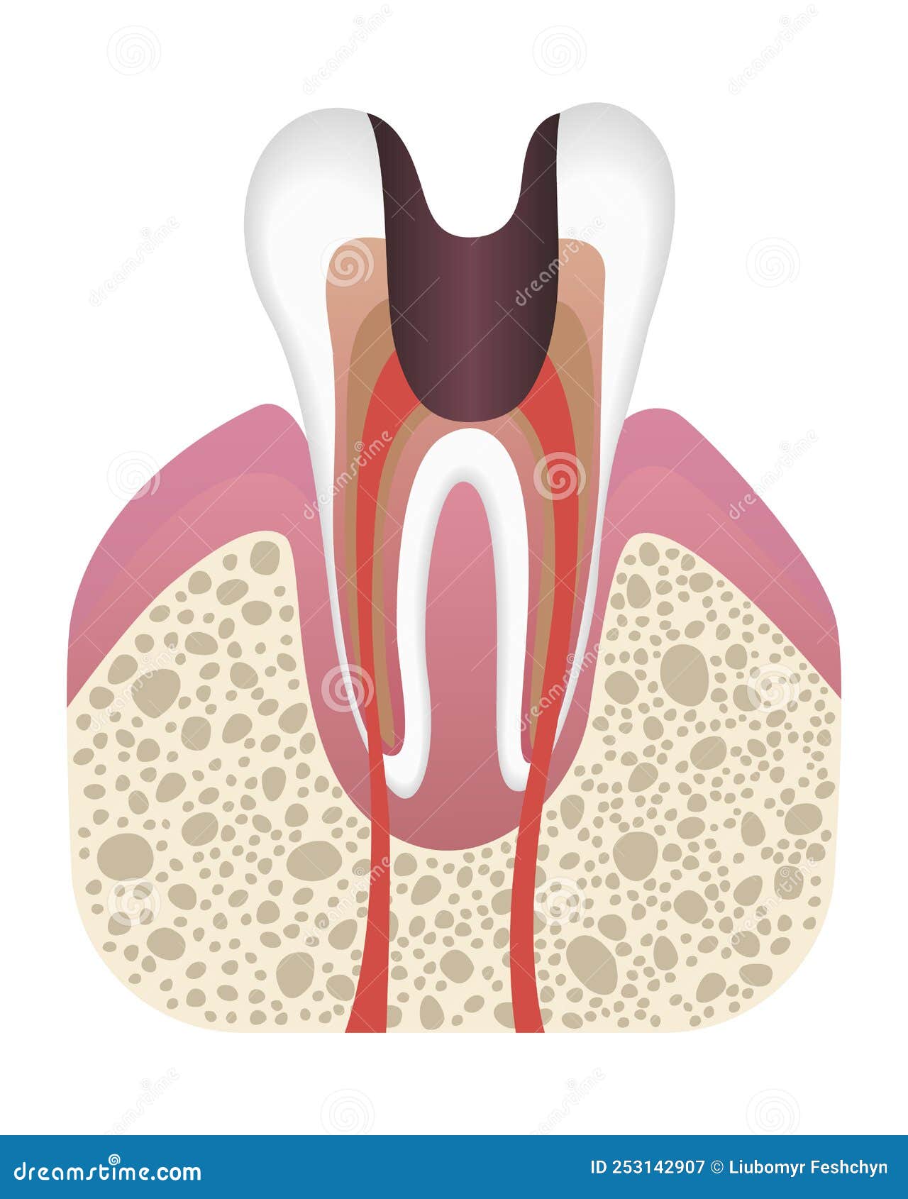 Stage of Caries Development. Tooth Structure in Flat Style. Tooth Decay ...