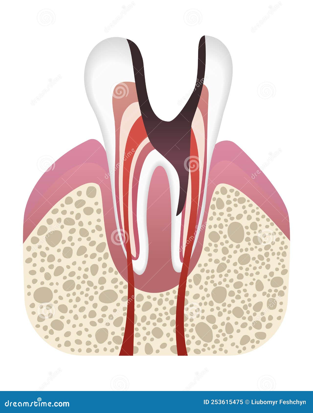 Stage of Caries Development. Tooth Structure in Flat Style. Tooth Decay ...