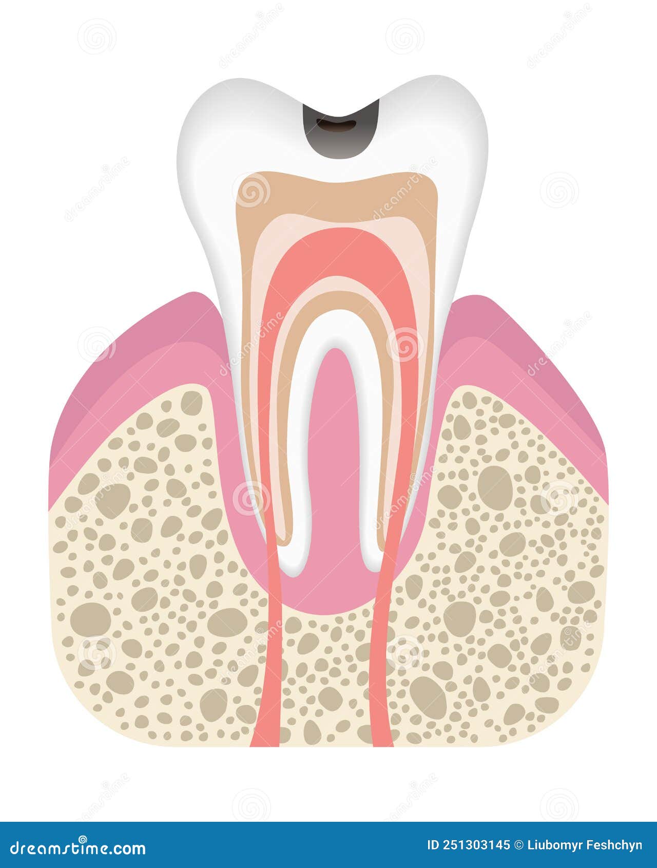 Caries Development. Dental Disease Stages: Enamel And Dentin Caries ...