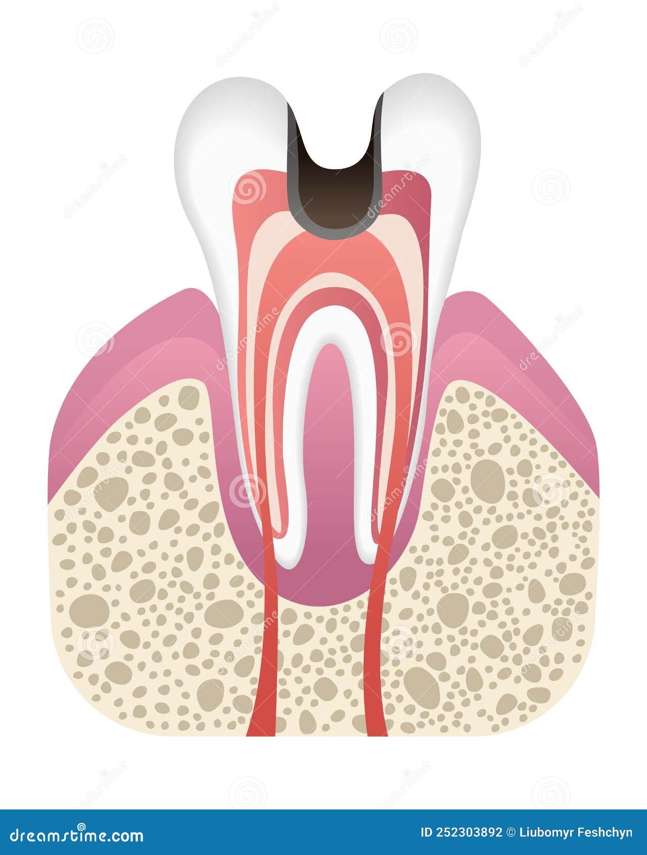Stage of Caries Development. Tooth Structure in Flat Style. Tooth Decay ...