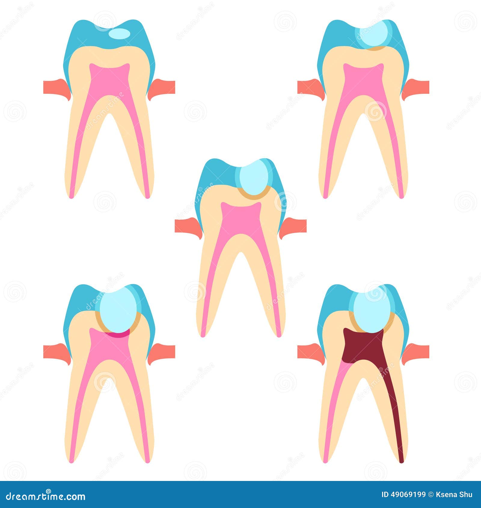 Stage Of Caries Development. Tooth Structure In Flat Style. Tooth Decay ...