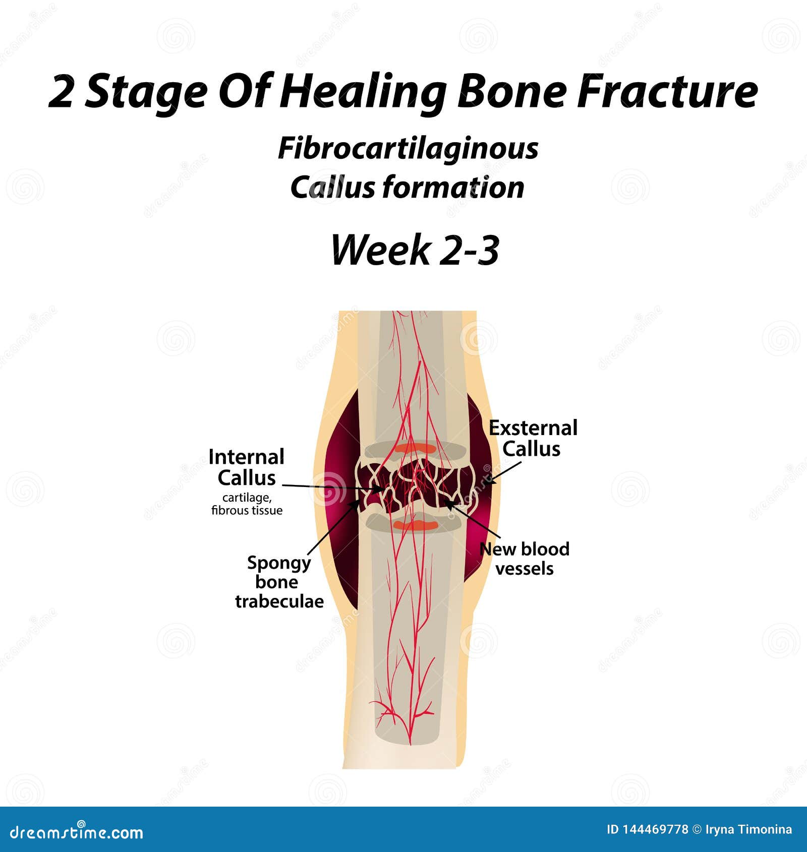 Bone Healing Process After A Bone Fracture Vector Illustration ... Bone Healing Process After A Bone Fracture Vector Illustration ...