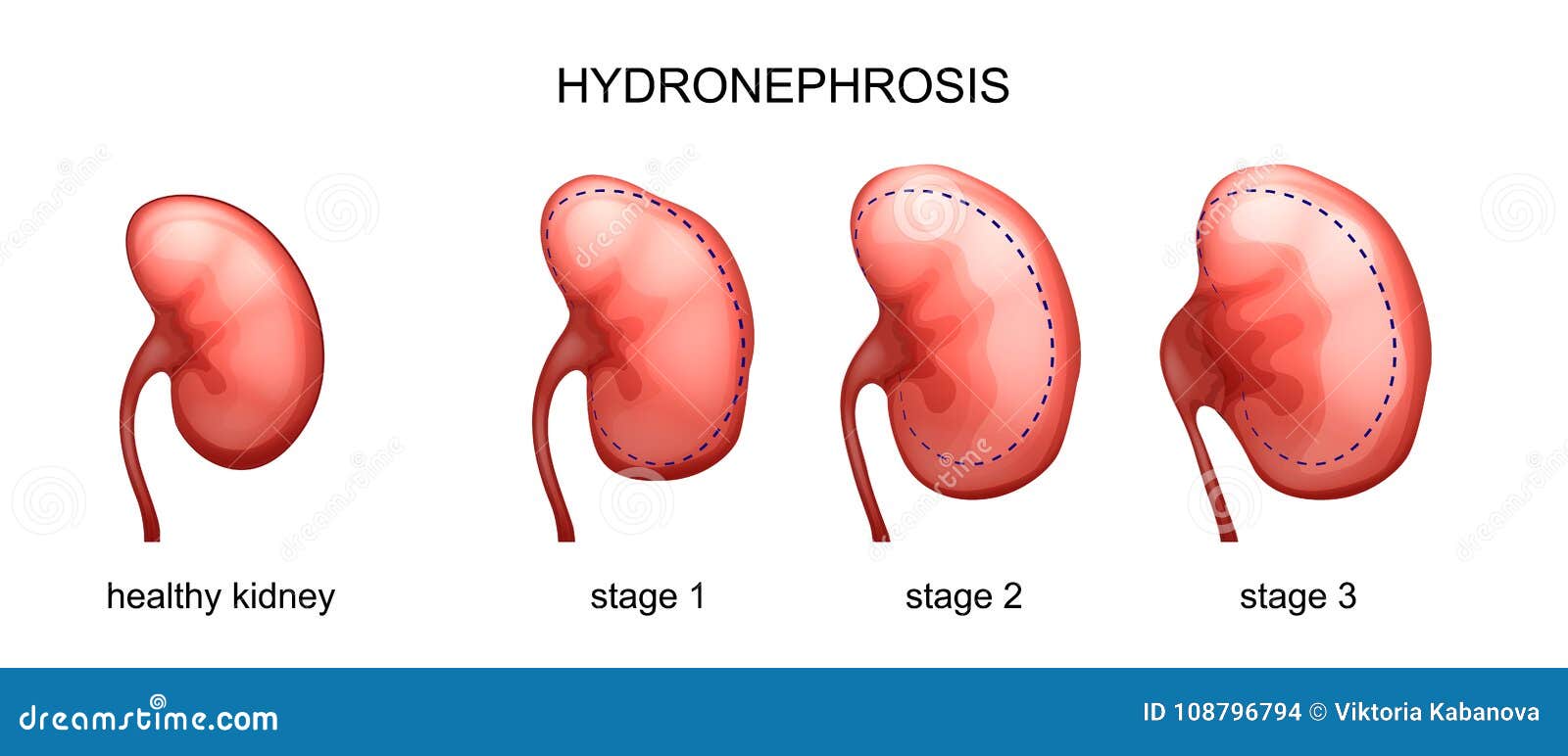 The Stage of Hydronephrosis Stock Vector - Illustration of health ...