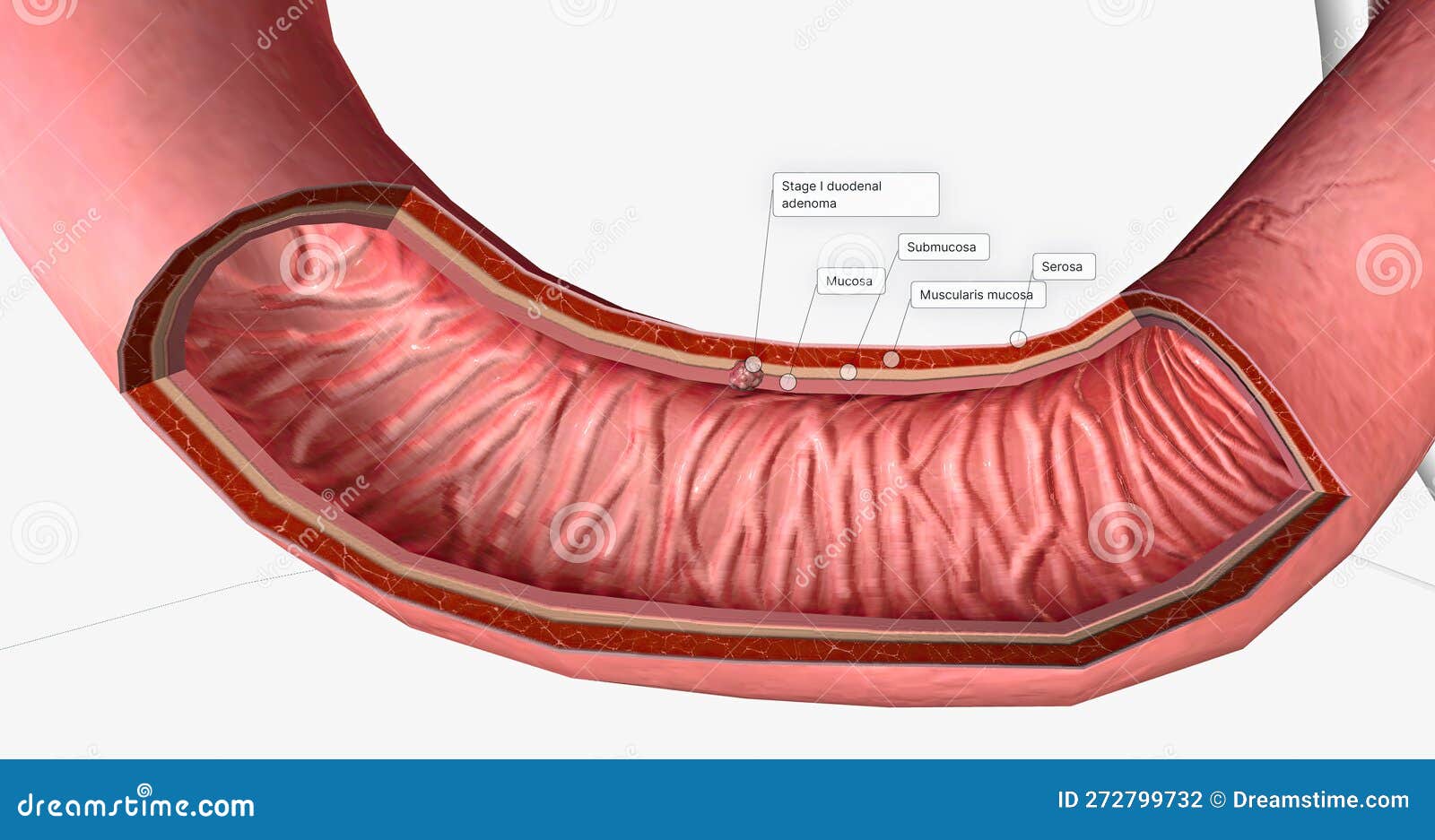 Duodenal Cancer Helicobacter Royalty-Free Stock Photo | CartoonDealer ...