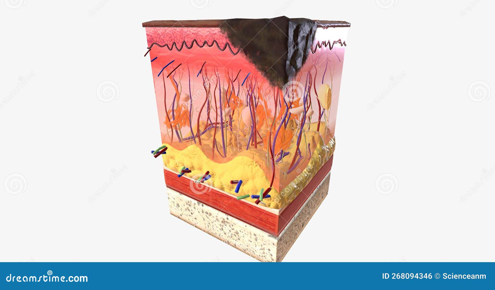 The in Stage II ALM Acral Lentiginous Melanoma Stock Illustration ...