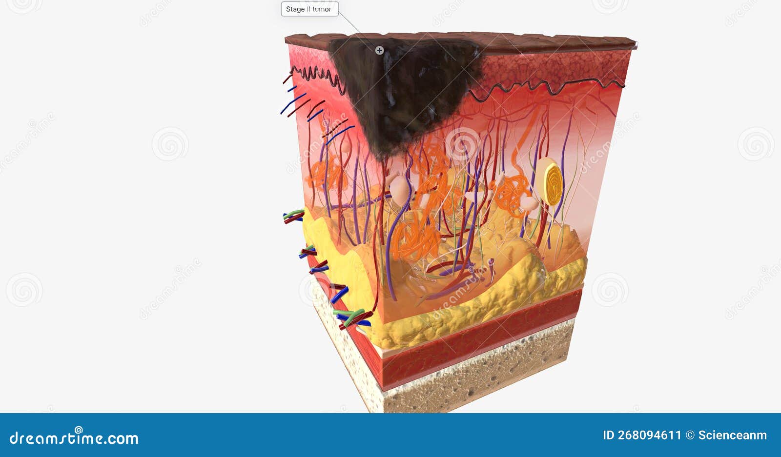 The in Stage II ALM Acral Lentiginous Melanoma Stock Illustration ...