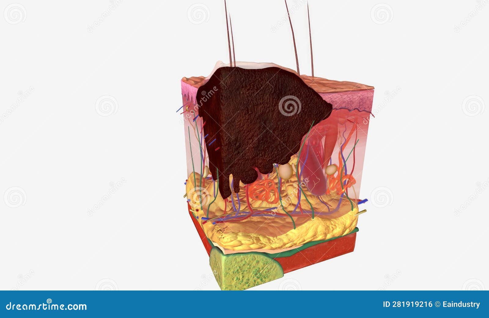 Stage I Melanoma Tumors Have Spread Out Of The Epidermis And Into The ... Stage I Melanoma Tumors Have Spread Out Of The Epidermis And Into The ...