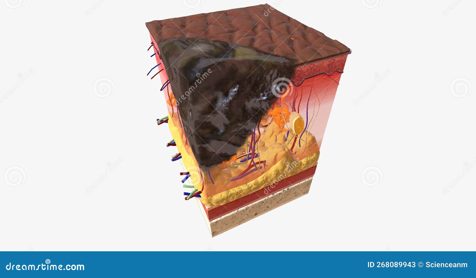 The in Stage III ALM Acral Lentiginous Melanoma Stock Illustration ...