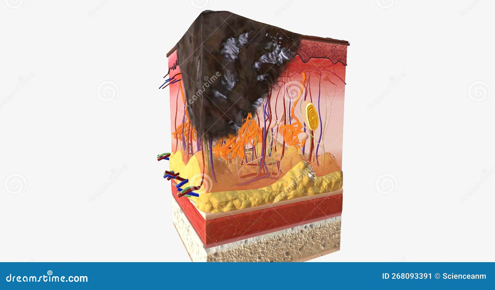 The in Stage III ALM Acral Lentiginous Melanoma Stock Illustration ...