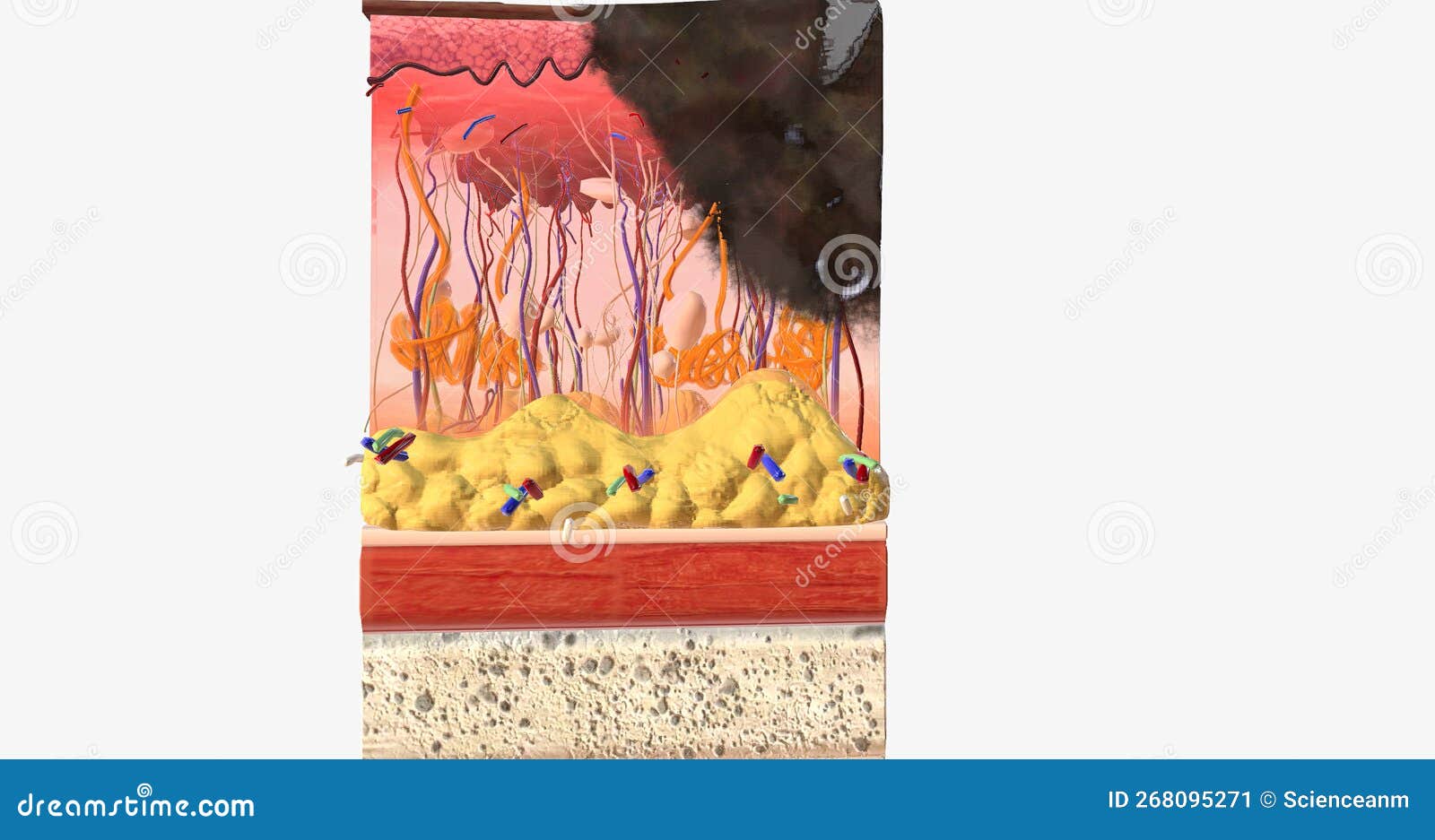 The in Stage III ALM Acral Lentiginous Melanoma Stock Illustration ...