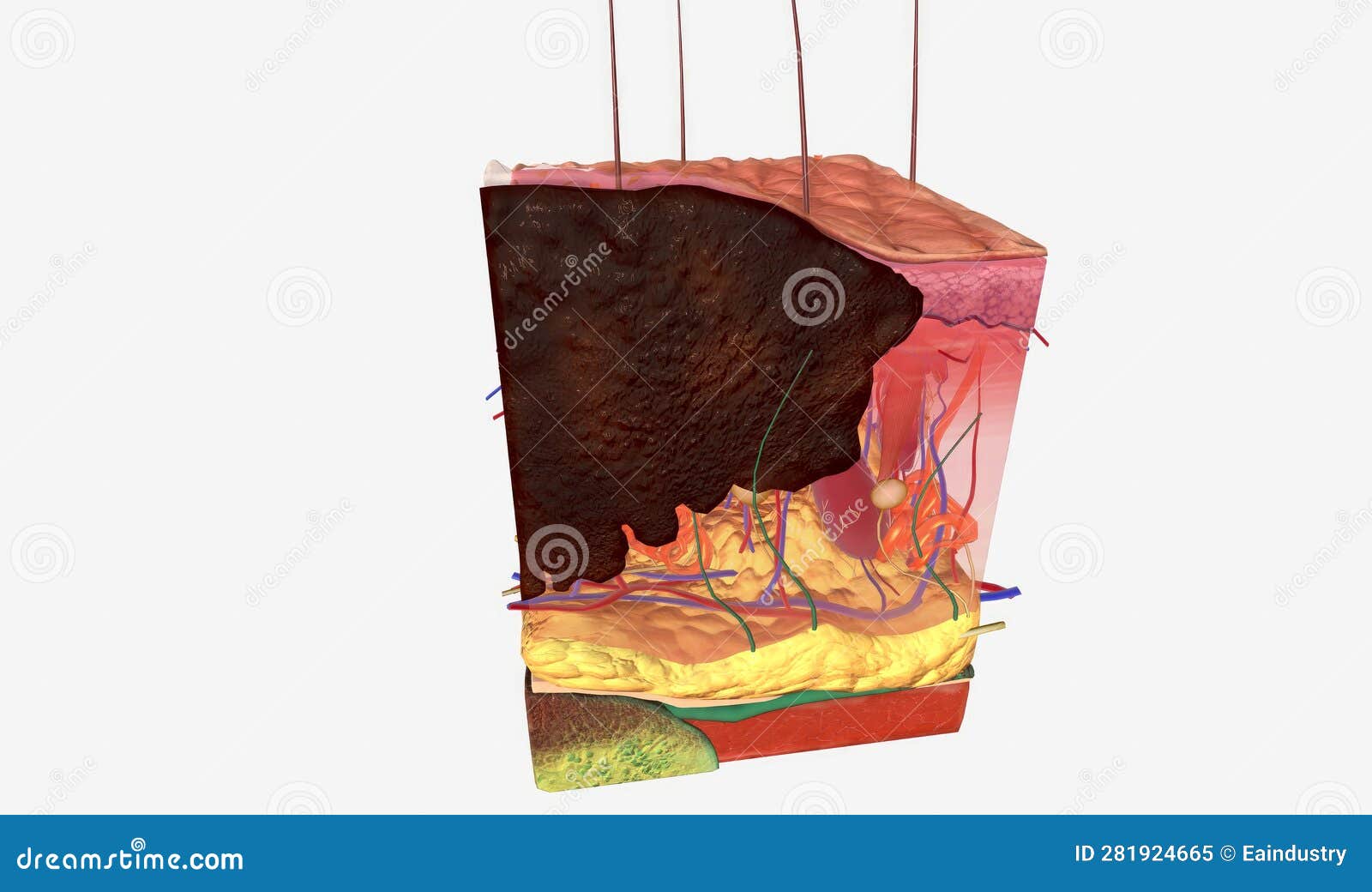 Stage I Melanoma Tumors Have Spread Out Of The Epidermis And Into The ... Stage I Melanoma Tumors Have Spread Out Of The Epidermis And Into The ...