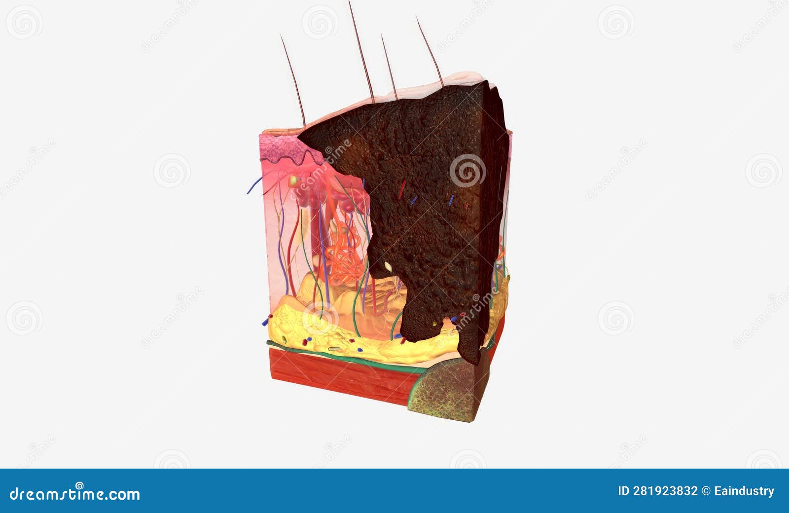 Stage I Melanoma Tumors Have Spread Out Of The Epidermis And Into The ... Stage I Melanoma Tumors Have Spread Out Of The Epidermis And Into The ...