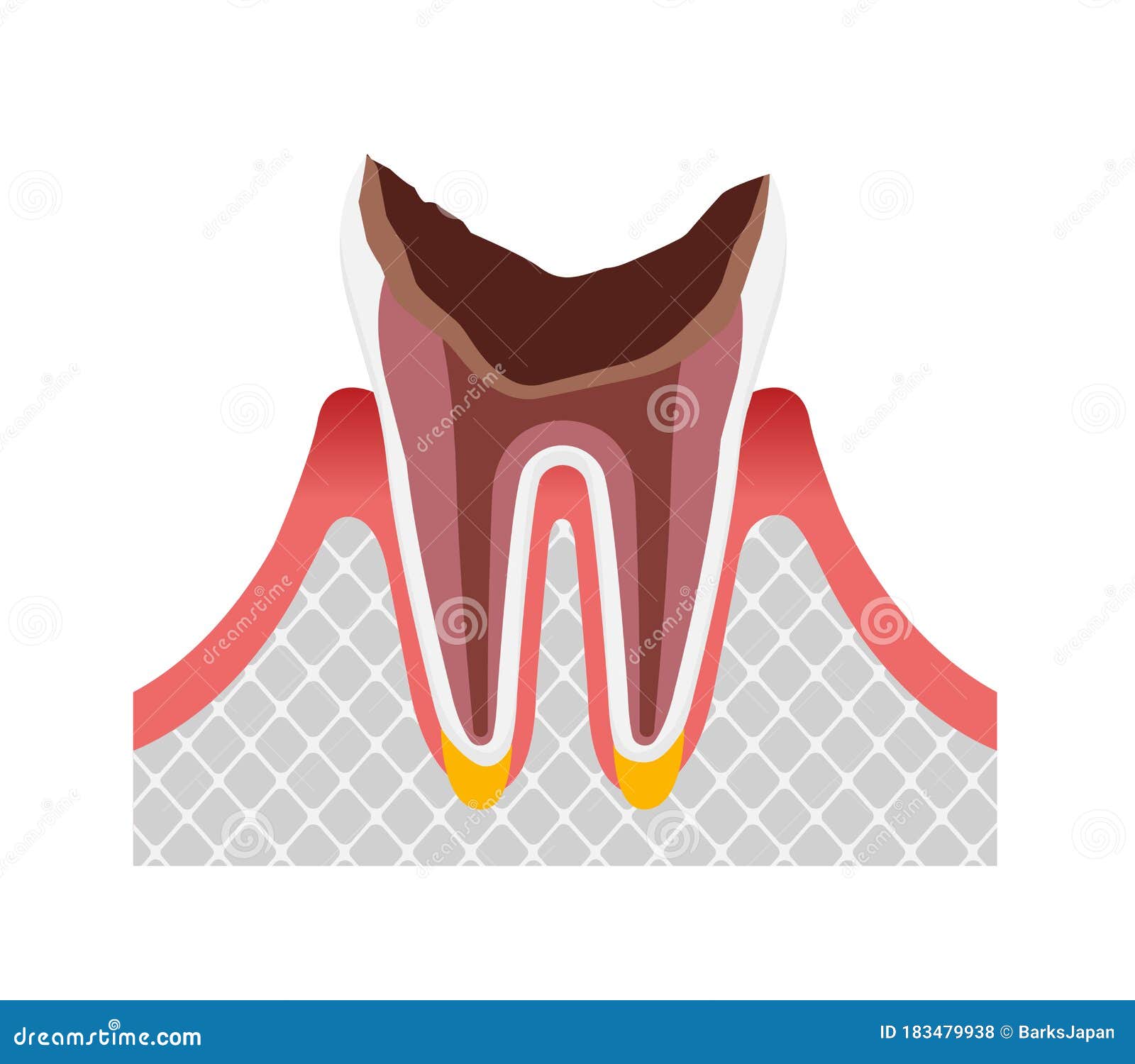The Stage Of Tooth Decay Illustration / Dead Tooth | CartoonDealer.com ...