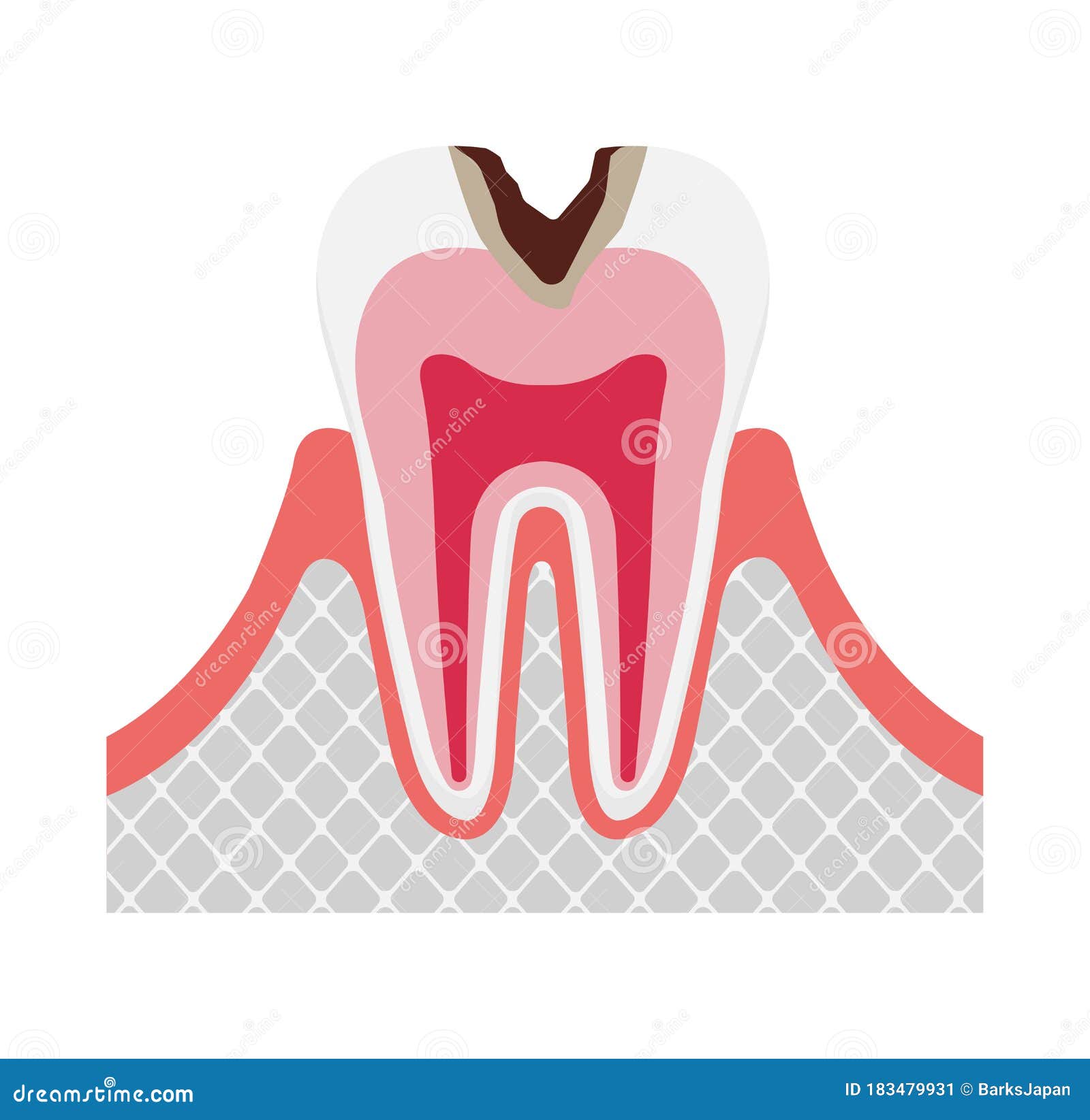 The Stage Of Tooth Decay Illustration / Decay In Dentin Cartoon Vector ...