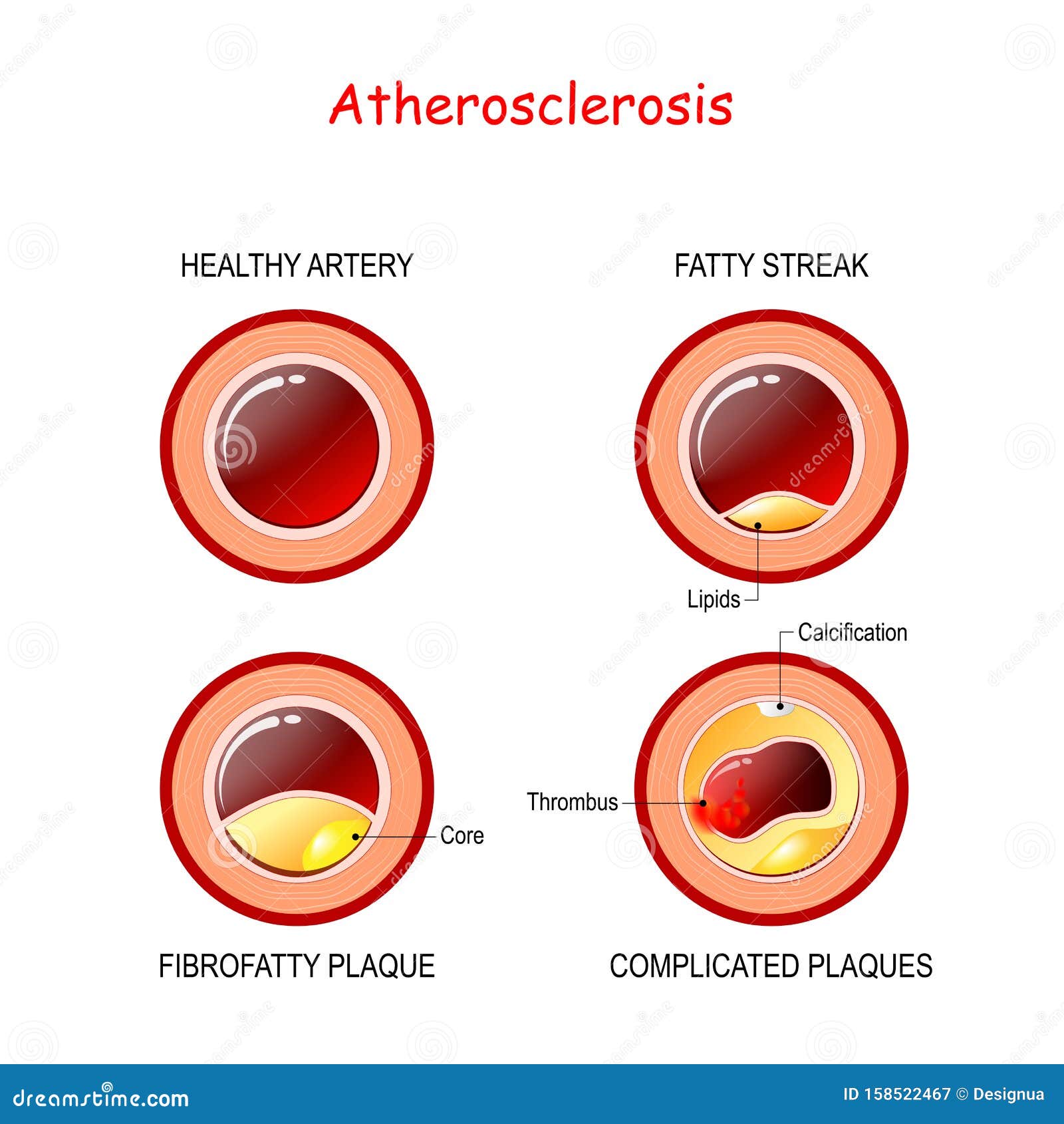 Stages of Atherosclerosis. Cholesterol in Artery Stock Vector ... Stages of Atherosclerosis. Cholesterol in Artery Stock Vector ...