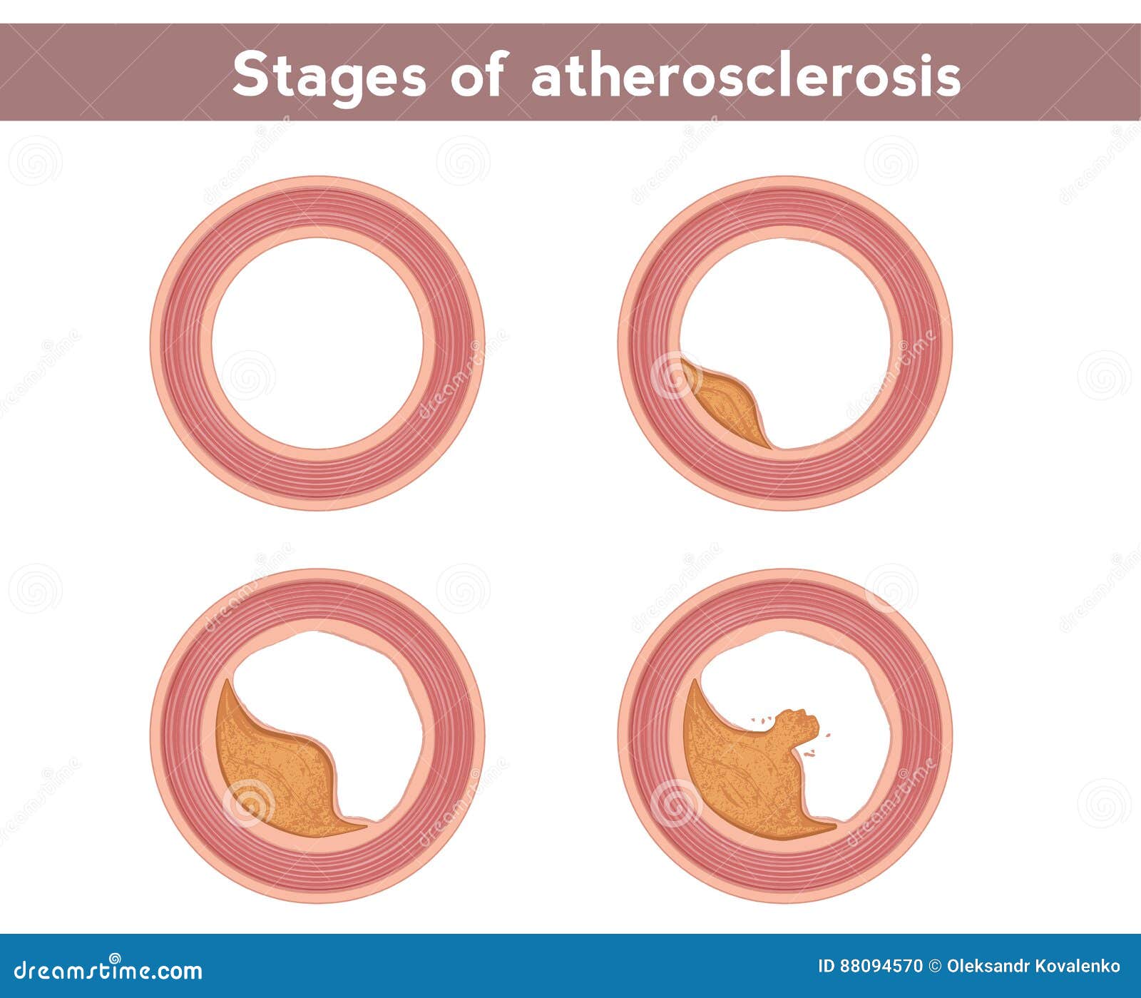 Stages of Atherosclerosis. Development of Atherosclerosis in the Lumen ...
