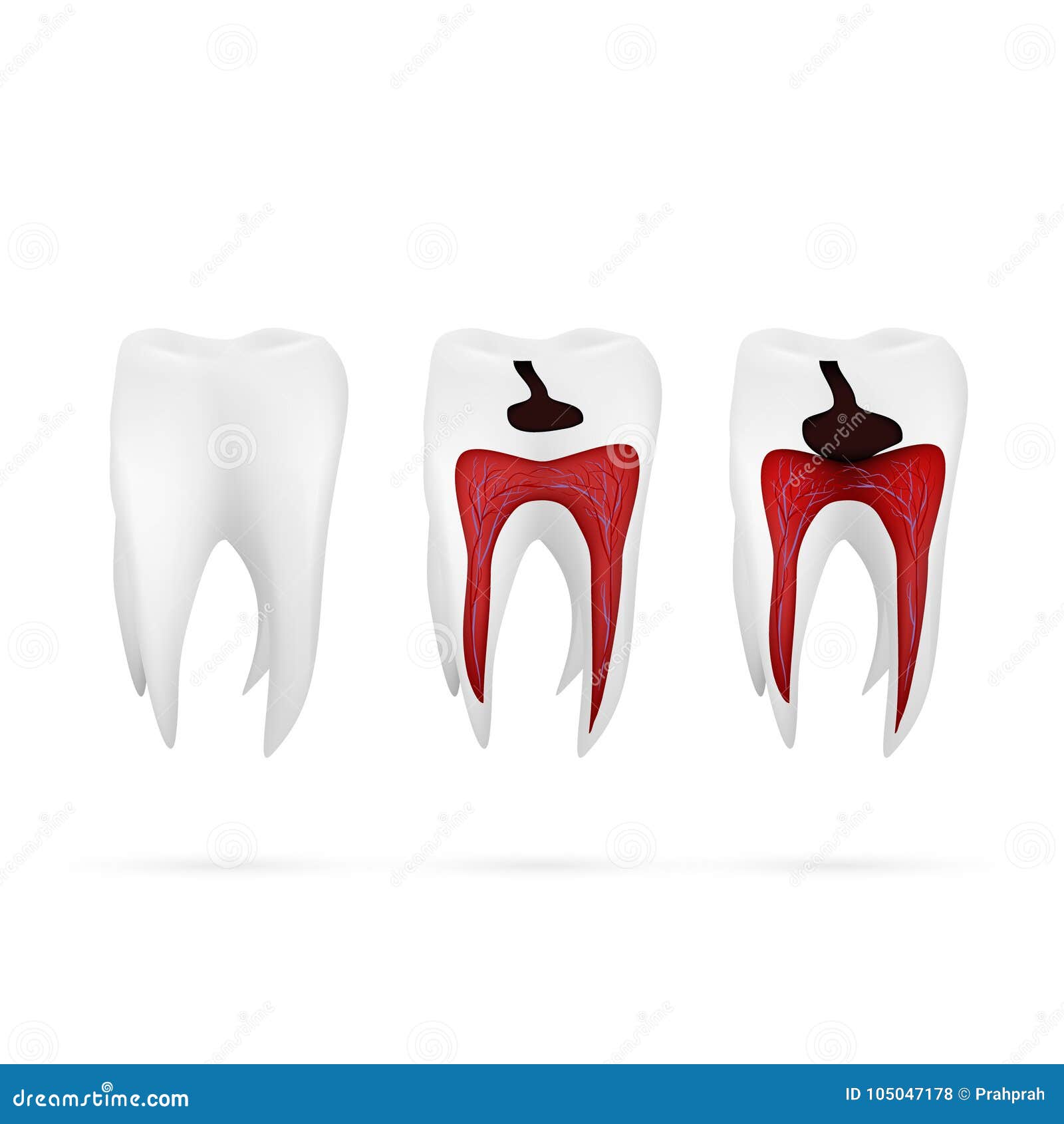 Caries Development. Dental Disease Stages: Enamel And Dentin Caries ...