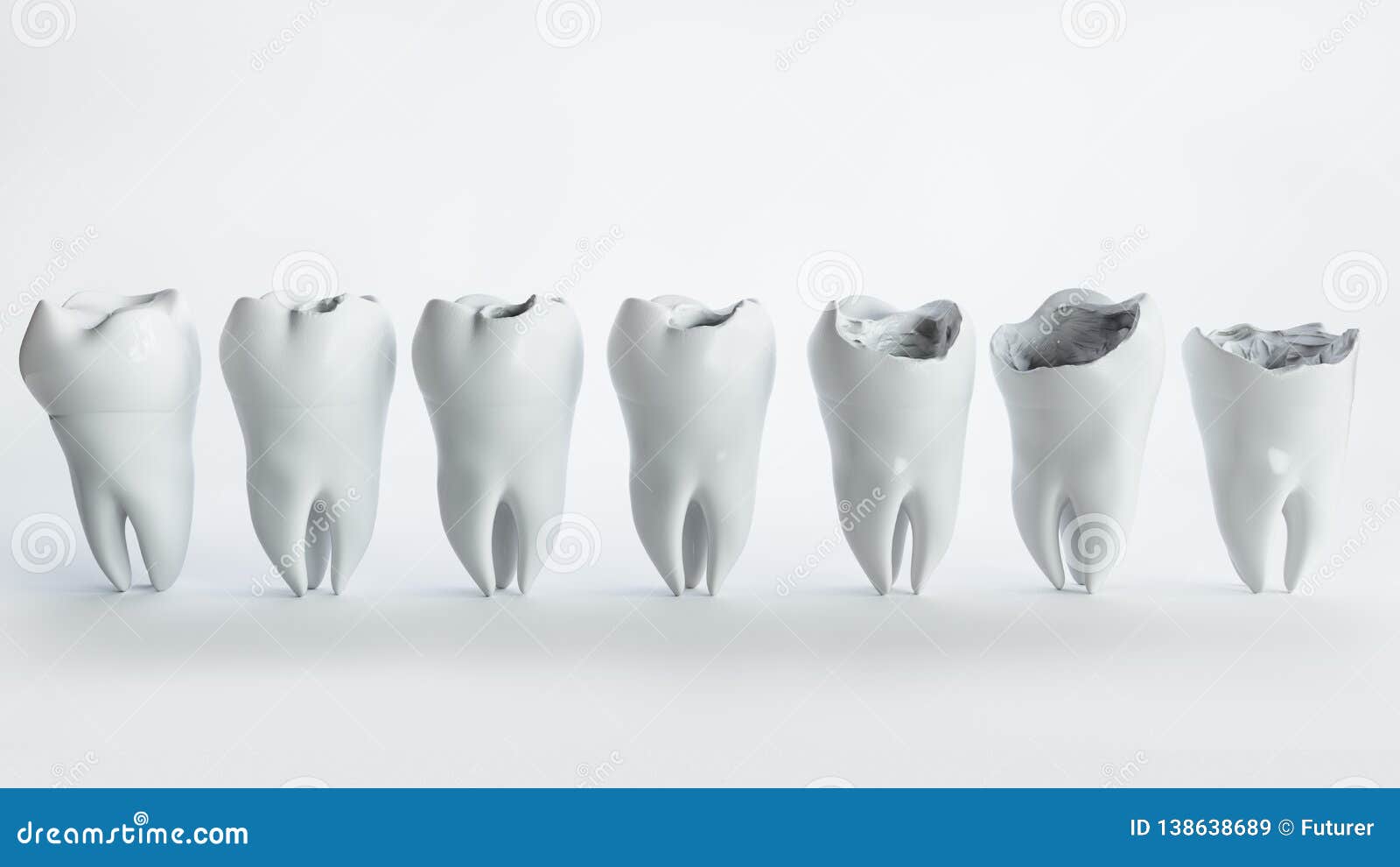The Stages of Caries on the Molar - 3D Rendering Stock Illustration ...