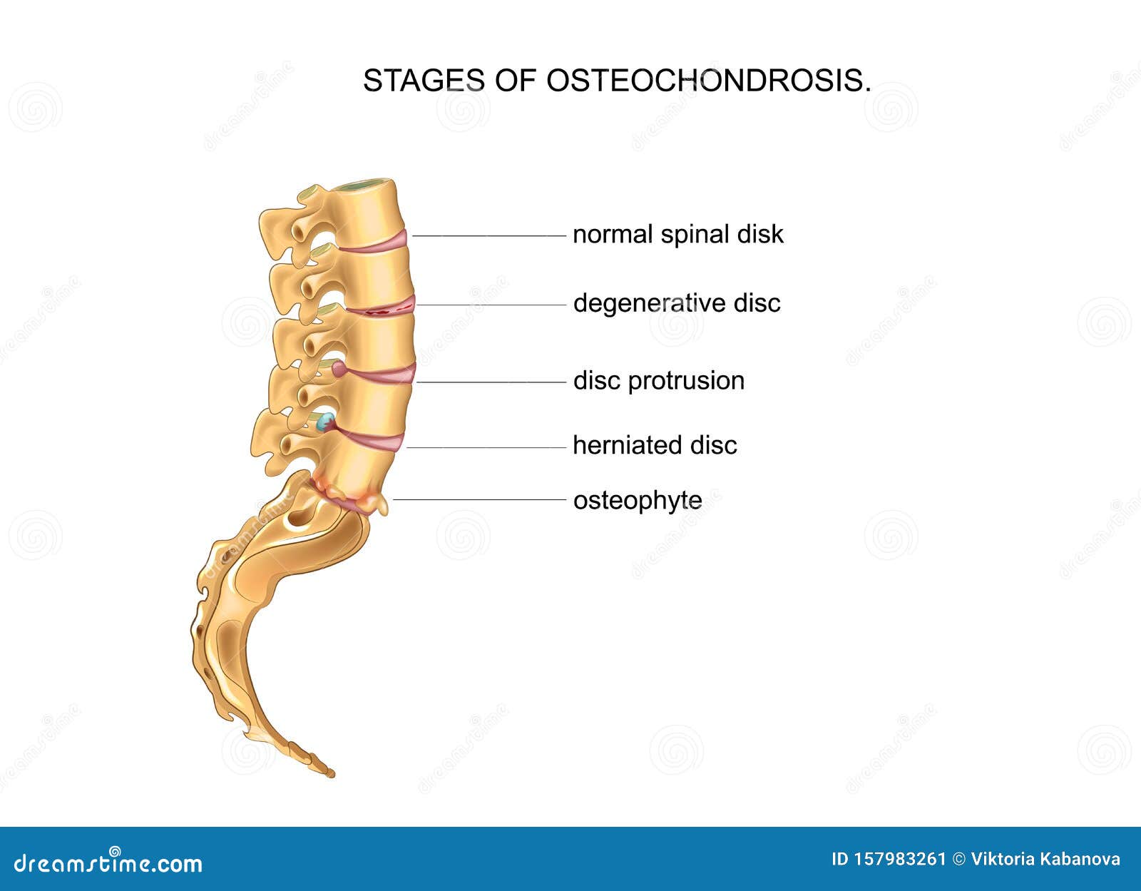 Stages of Degenerative Disc Disease Stock Vector - Illustration of ...
