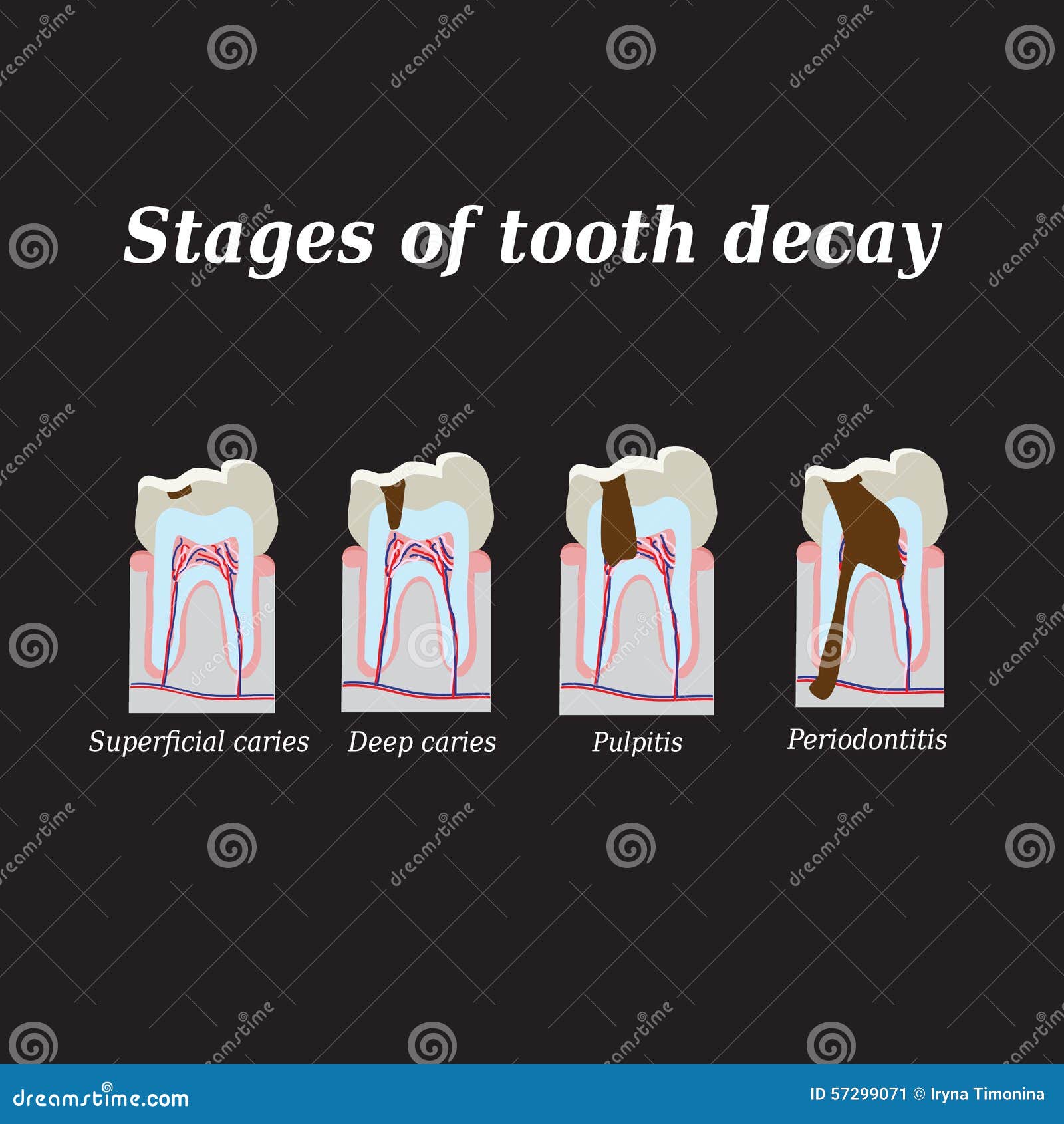 Stages Of Development Of Dental Caries Vector Stock Vector