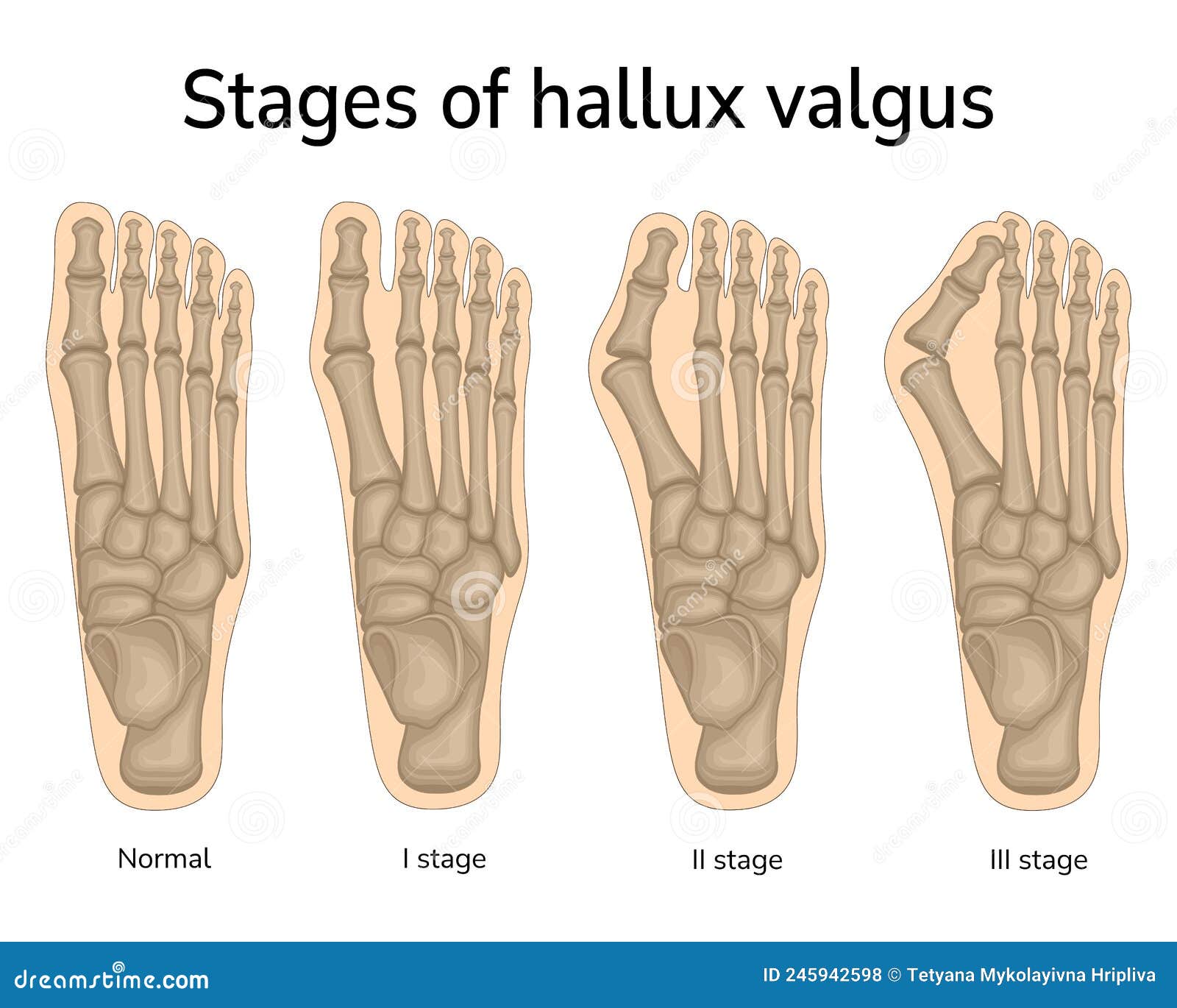 Stages of hallux valgus stock vector. Illustration of medicine - 245942598