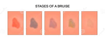 Stages of Healing of a Bruise Stock Vector - Illustration of lesion ...