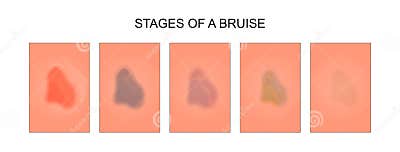 Stages of Healing of a Bruise Stock Vector - Illustration of lesion ...