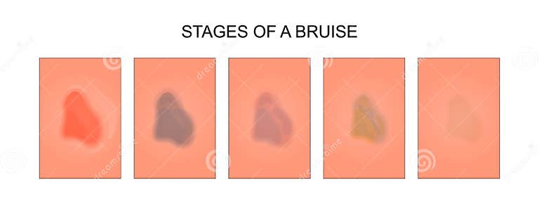 Stages of Healing of a Bruise Stock Vector - Illustration of lesion ...
