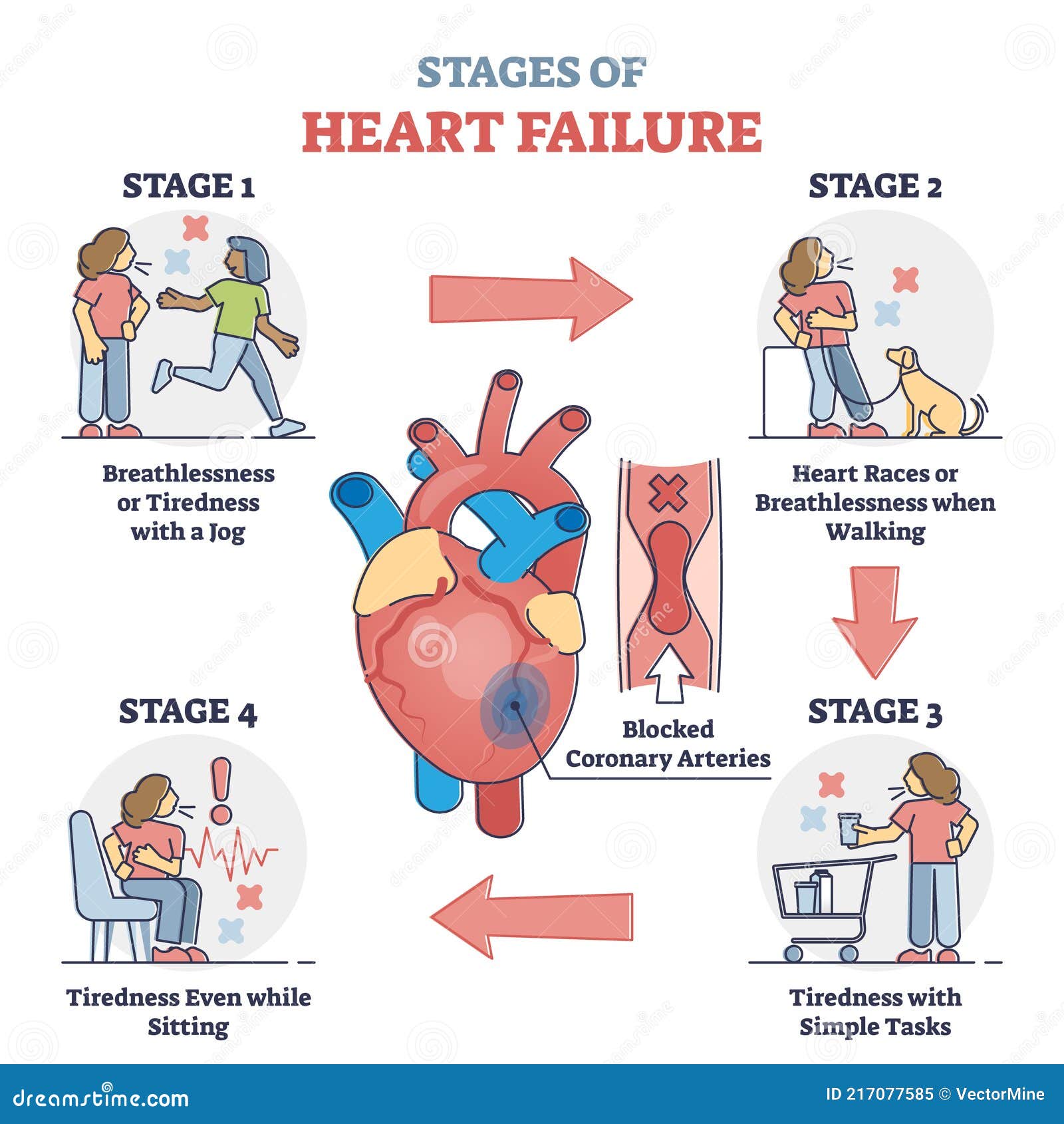 Congestive Heart Failure (CHF): Symptoms, Stages, Life, 40% OFF Congestive Heart Failure (CHF): Symptoms, Stages, Life, 40% OFF