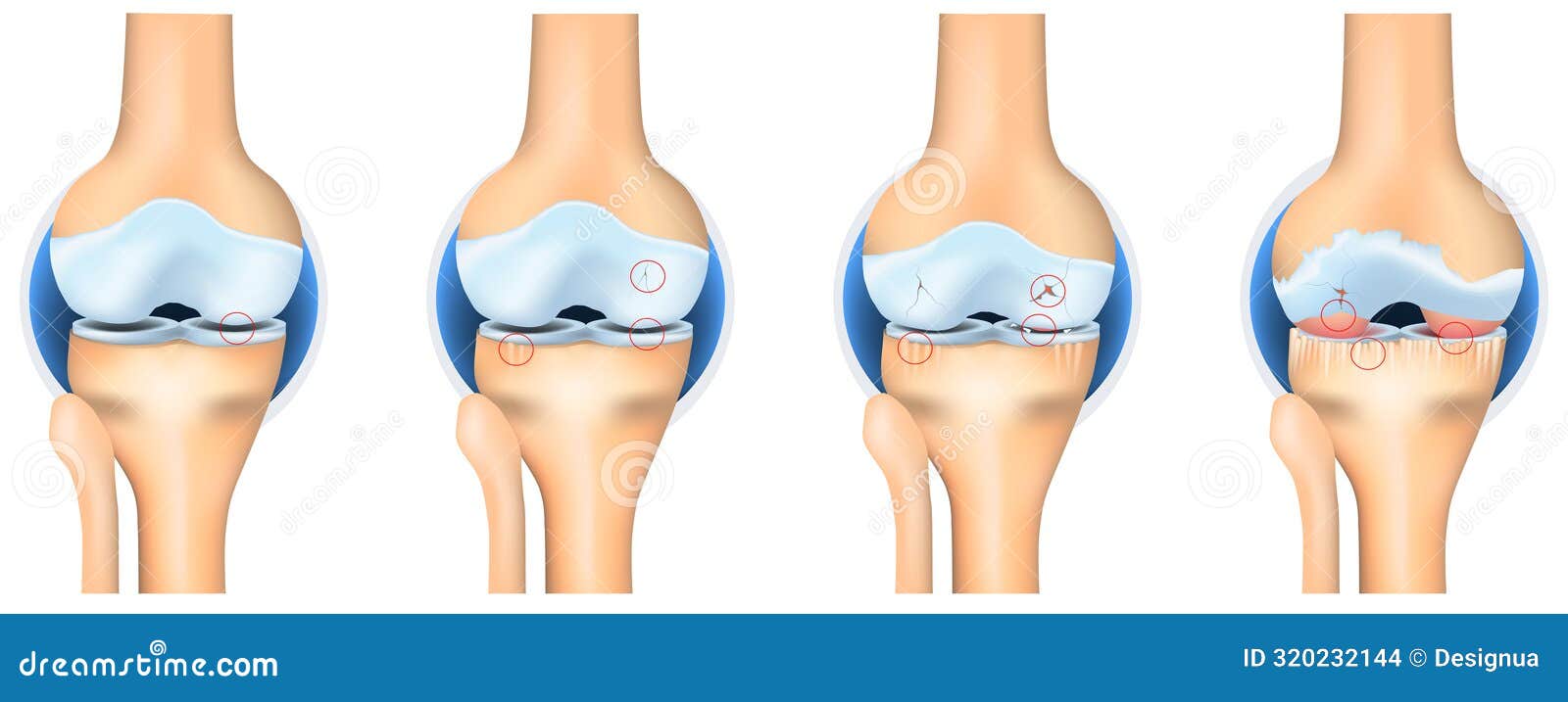 Stages Of Osteoarthritis. Knee Joint Anatomy Vector Illustration ...