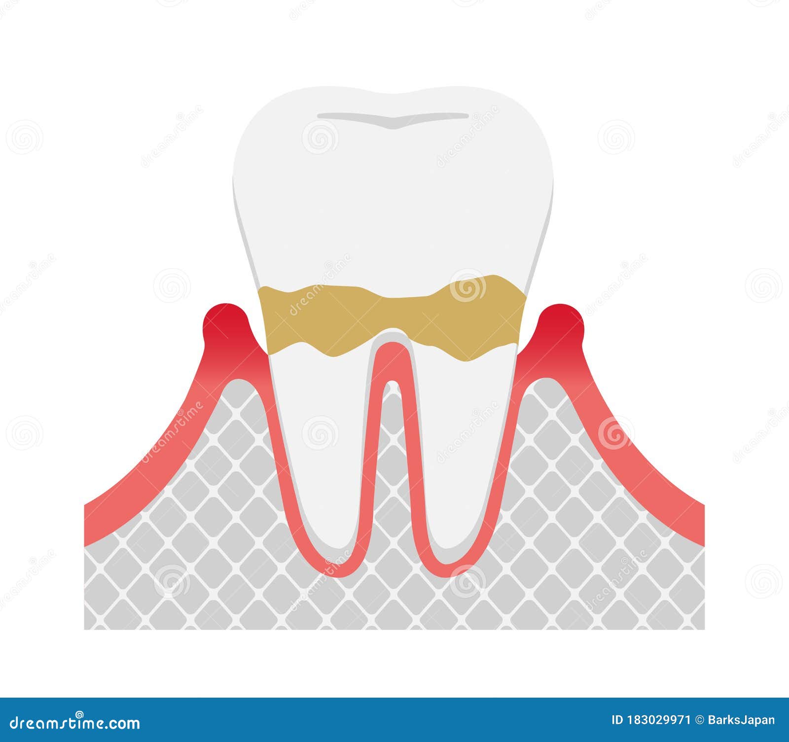 The Stages of Periodontitis Disease Illustration / Mild Periodontitis ... The Stages of Periodontitis Disease Illustration / Mild Periodontitis ...