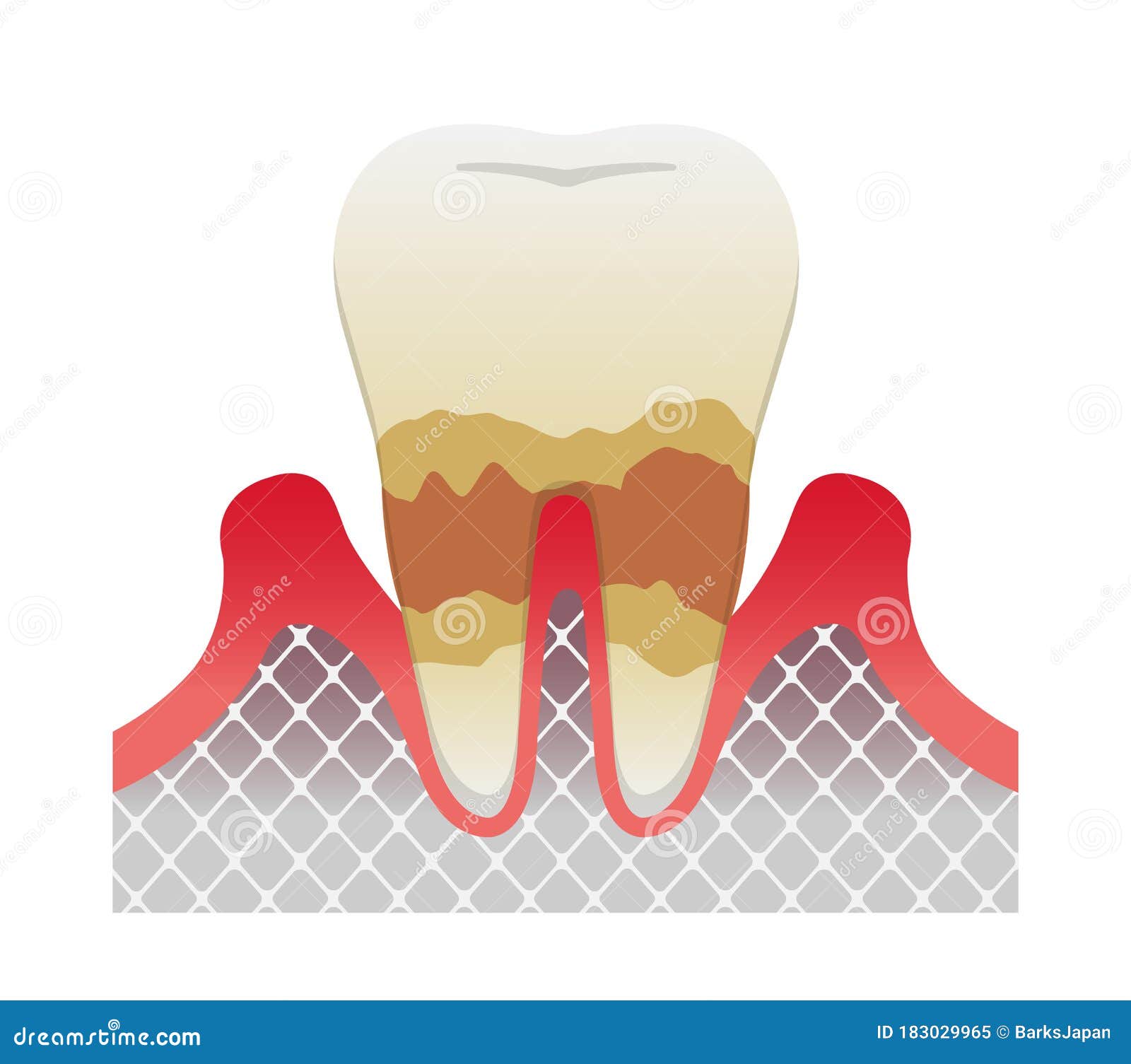 The Stages of Periodontitis Disease Illustration / Moderate ... The Stages of Periodontitis Disease Illustration / Moderate ...