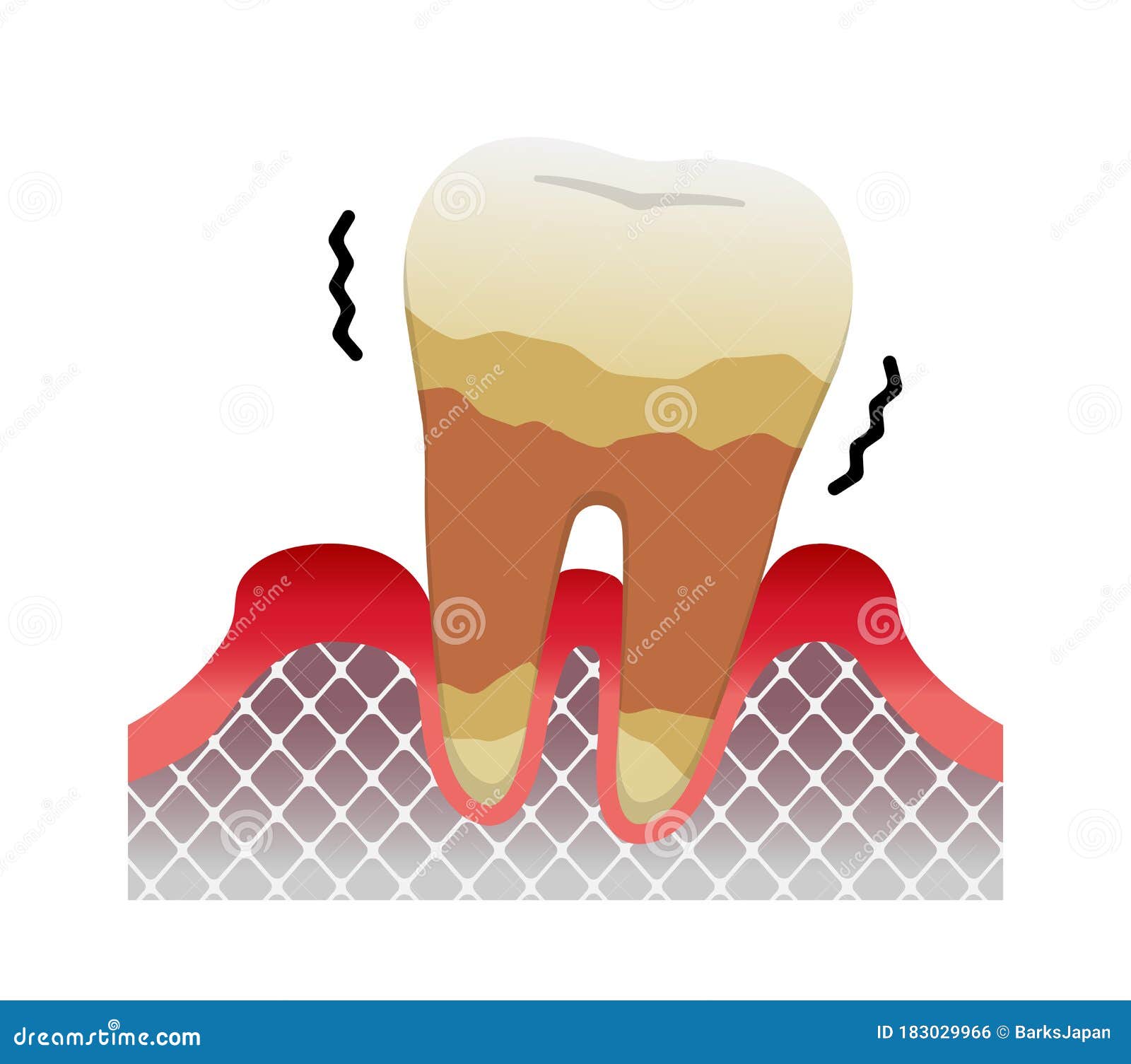 The Stages Of Periodontitis Disease Illustration / Moderate ...