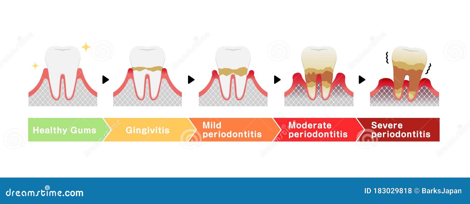 The Stages Of Periodontitis Disease Illustration / Moderate ...
