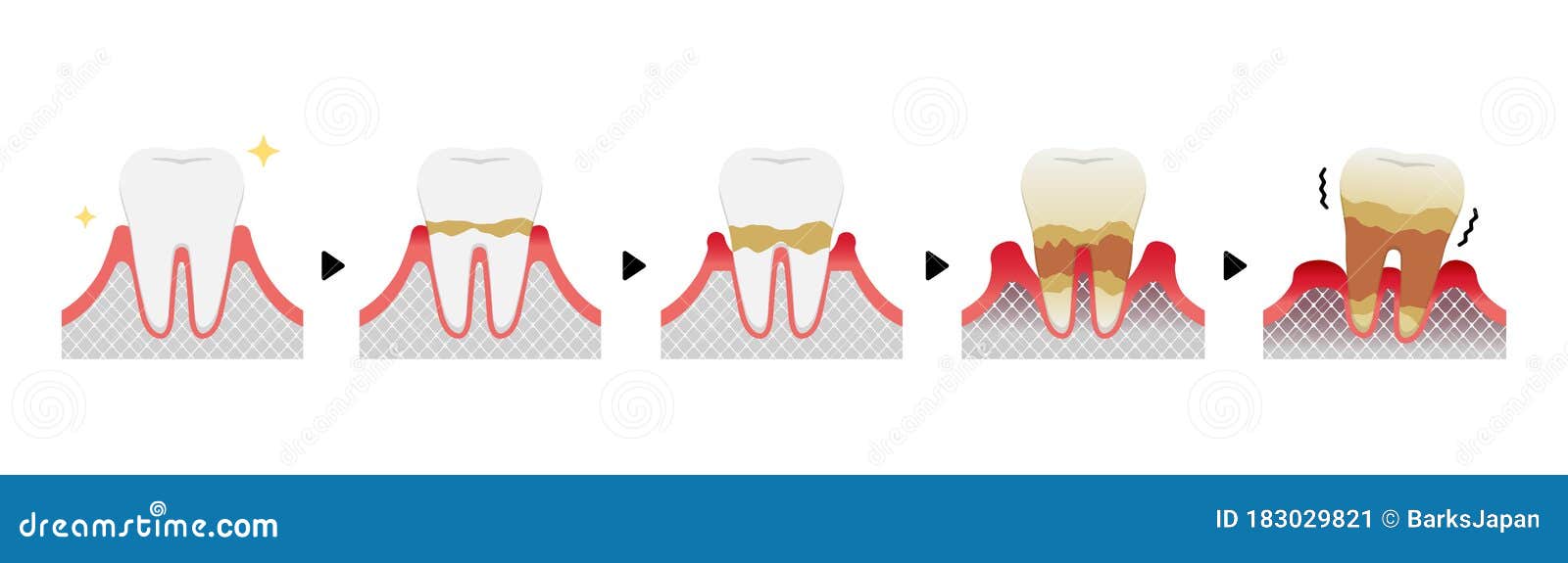 The Stages of Periodontitis Disease Vector Illustration Stock Vector ...