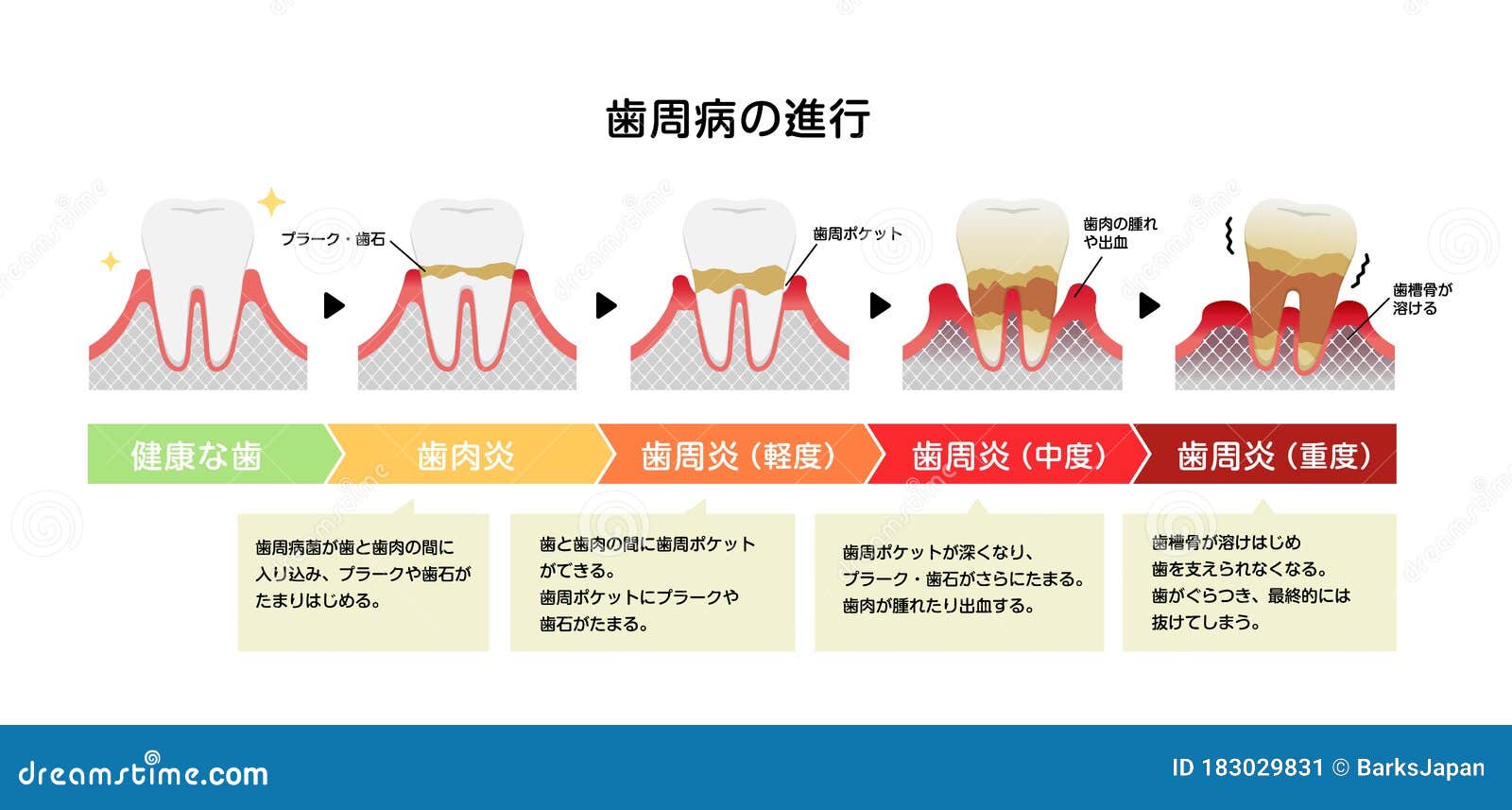 The Stages of Periodontitis Disease Vector Illustration Stock Vector ...