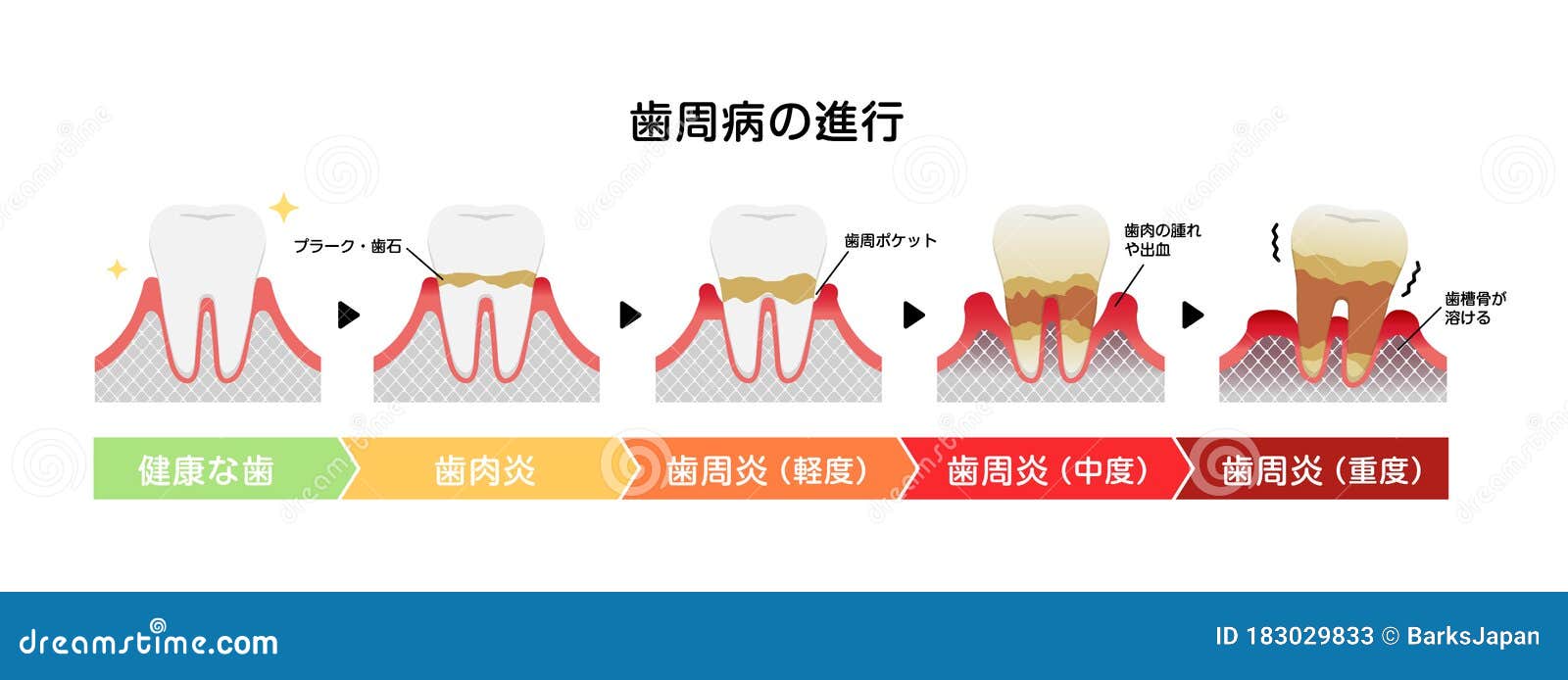 The Stages of Periodontitis Disease Vector Illustration Stock Vector ...