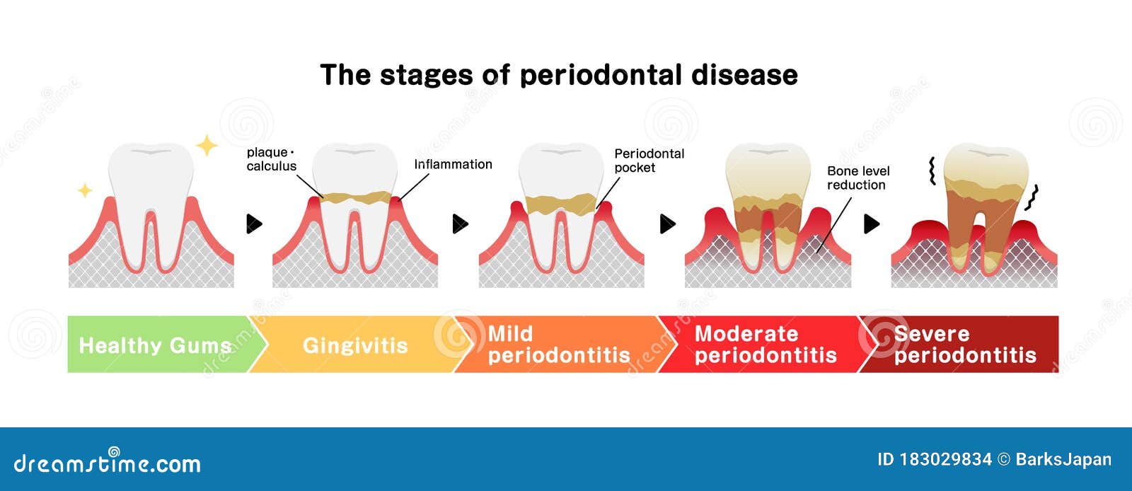 The Stages Of Periodontitis Disease Illustration / Mild Periodontitis ... The Stages Of Periodontitis Disease Illustration / Mild Periodontitis ...