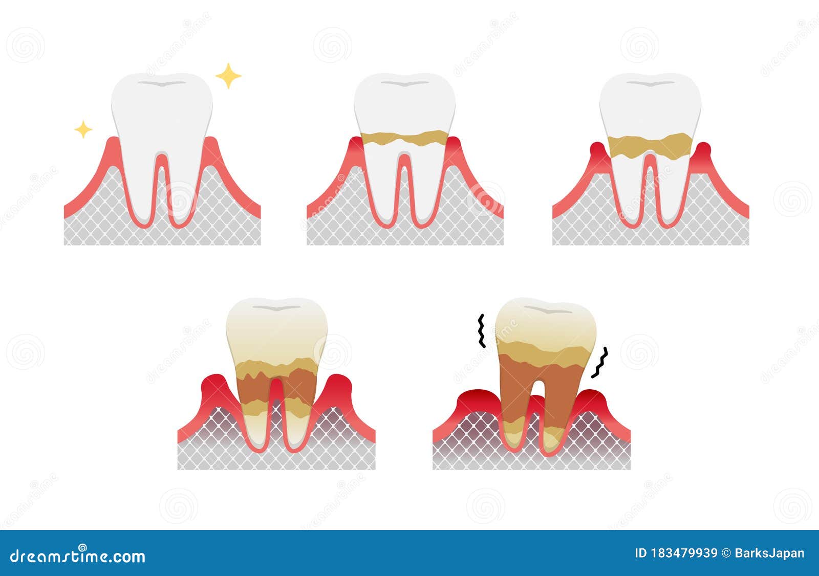 The Stages Of Periodontitis Disease Illustration / Mild Periodontitis ... The Stages Of Periodontitis Disease Illustration / Mild Periodontitis ...