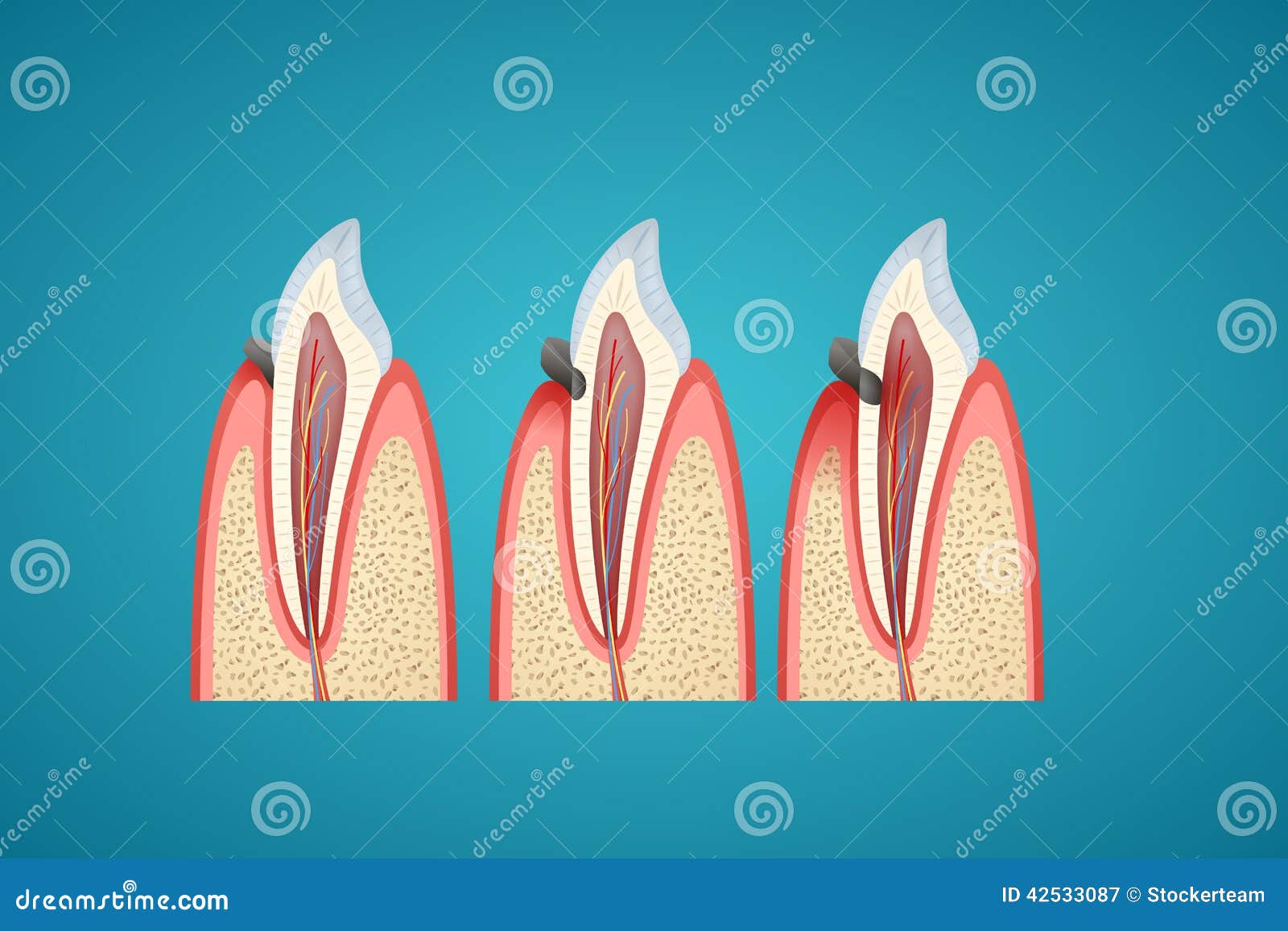 Stages Of Caries Development. Dental Disease: Caries, Pulpitis And ...