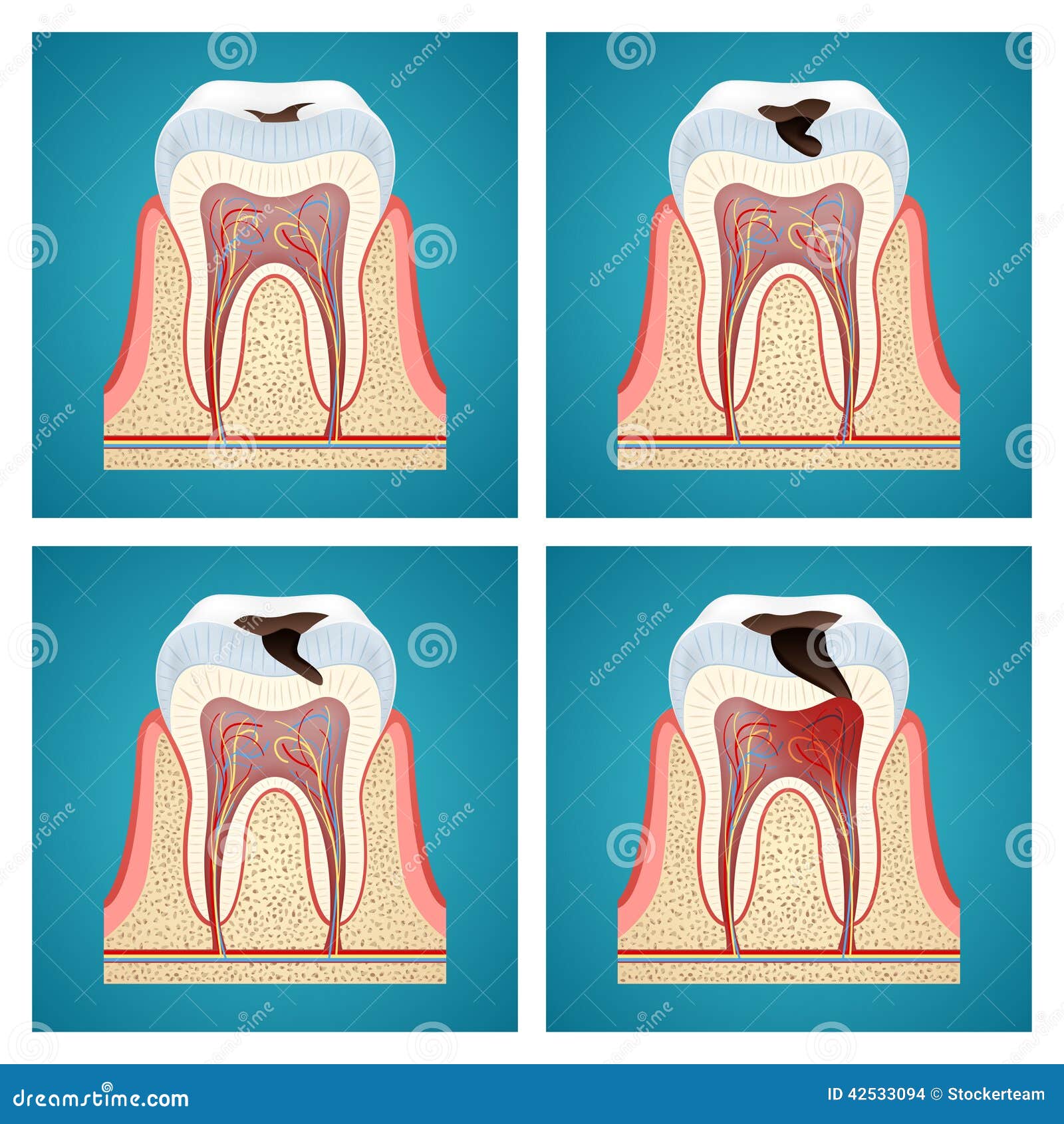 Stages Progress Dental Caries Stock Illustration - Illustration of ...